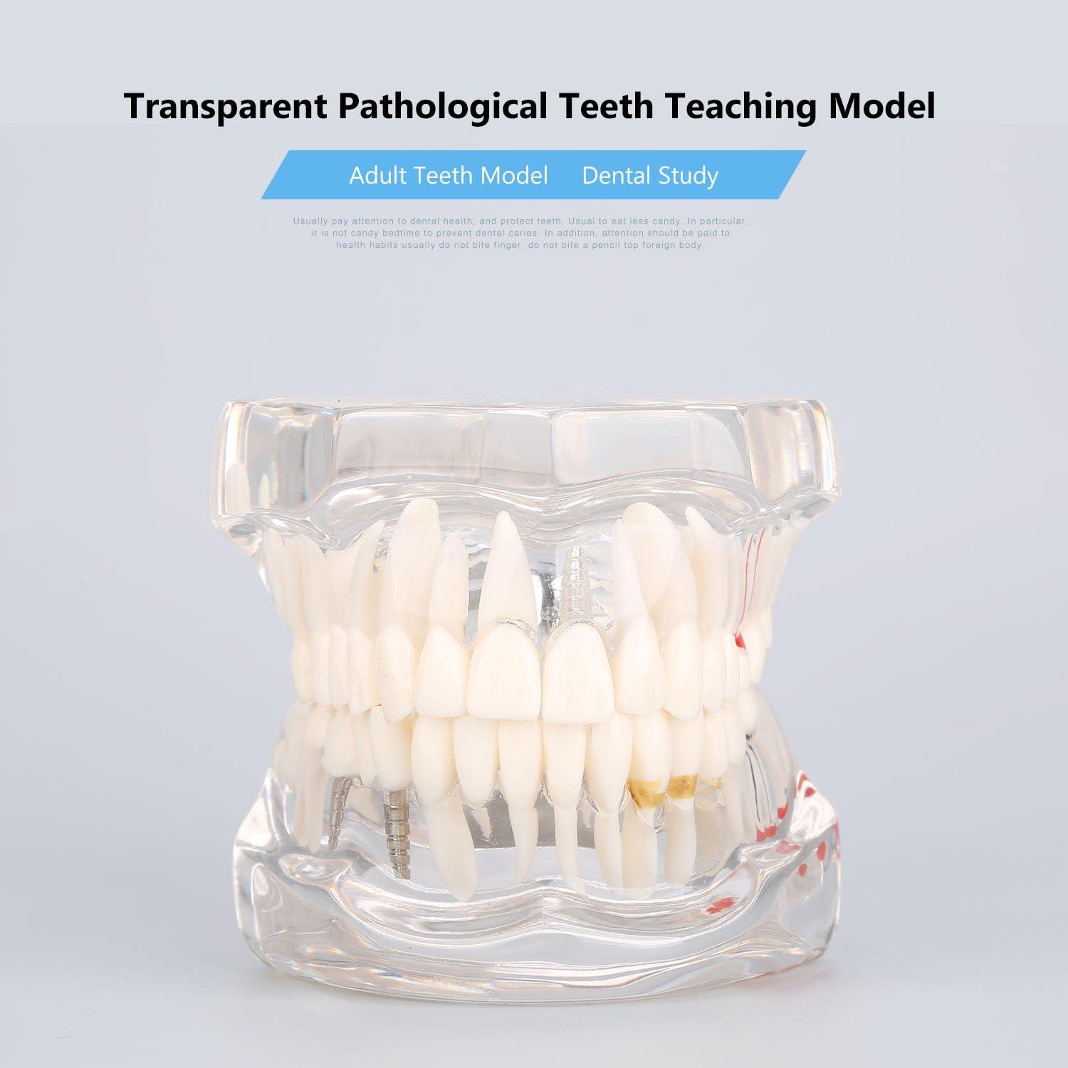 Buy Dental Diseases Teaching Study Adult Typodont Model - Realistic ...