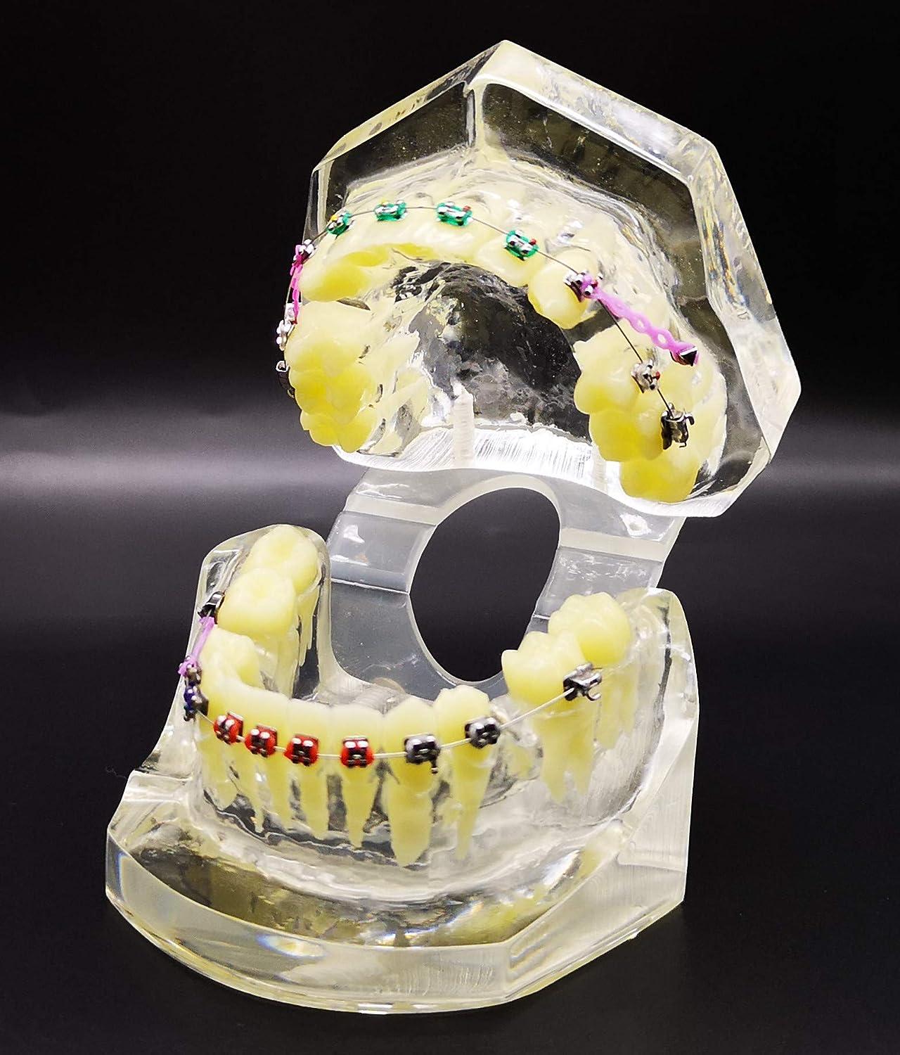 Dental Typodont Orthodontic Teeth Model with Metal Braces & Ligature ...