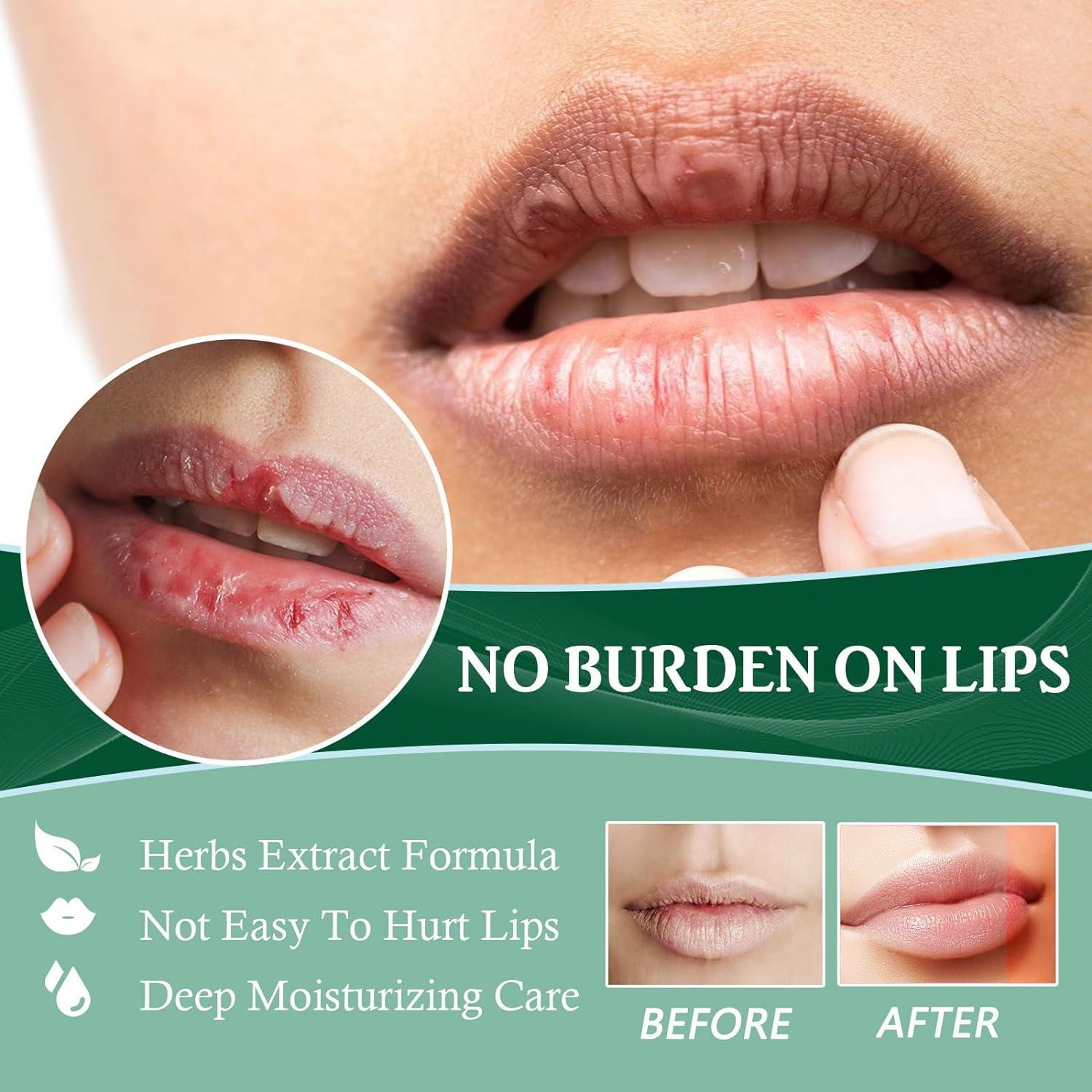 Mouth Ulcer Treatment Spray Mouth Ulcer Spray Canker Sore Treatment for ...