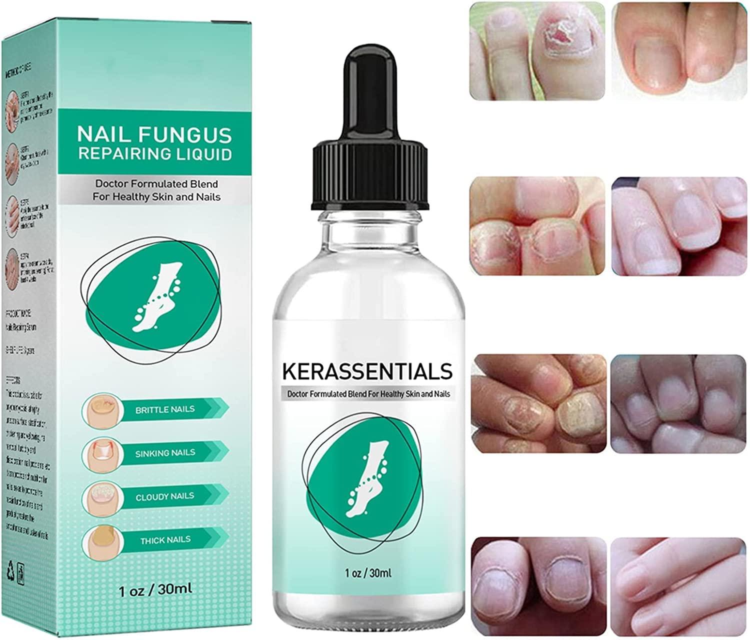 Kerassentials Toe Nails Lotion - Advanced Oil Formula with Applicator ...