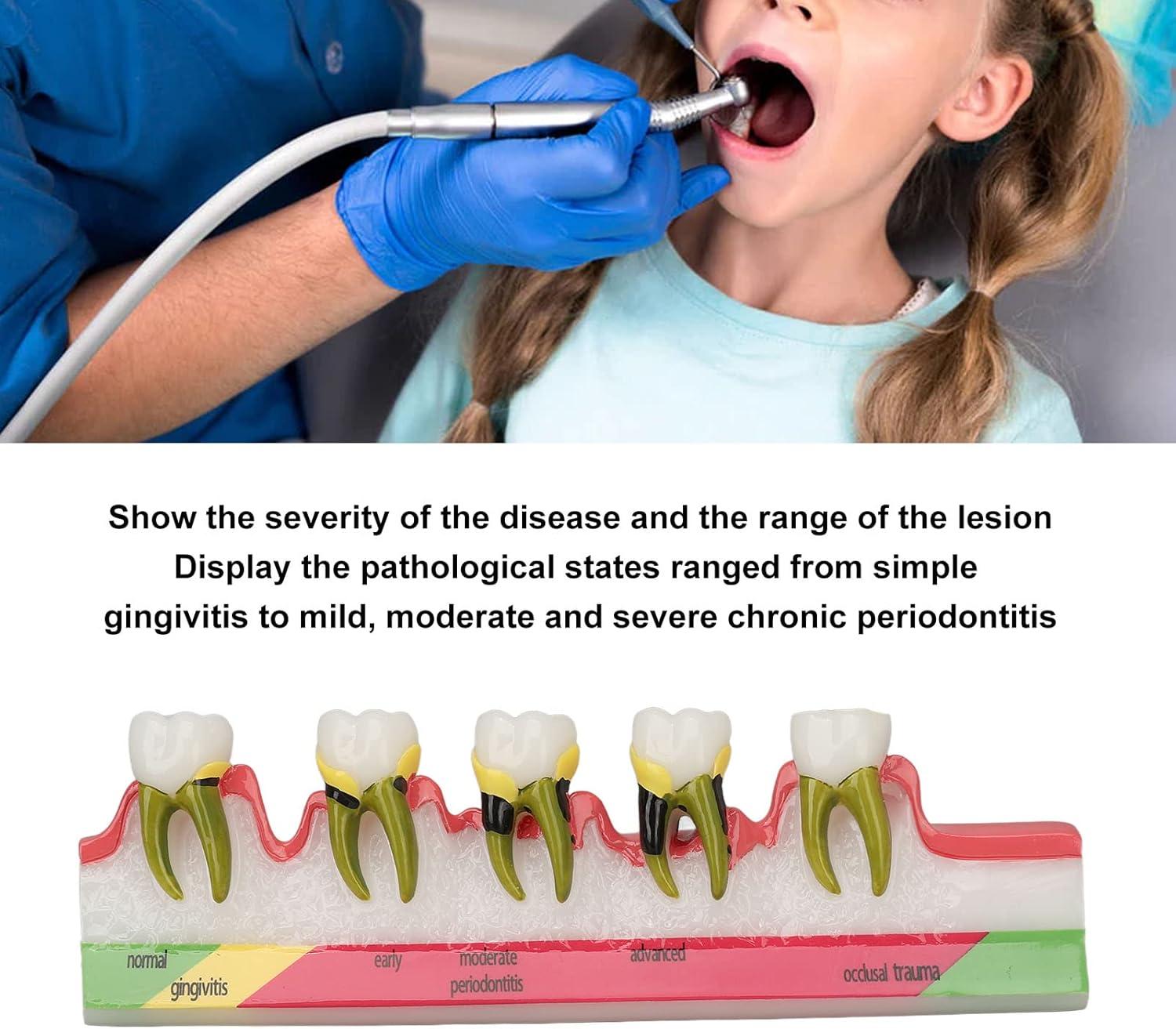 Realistic Dental Periodontitis Model - Study Dental Teeth in Various ...
