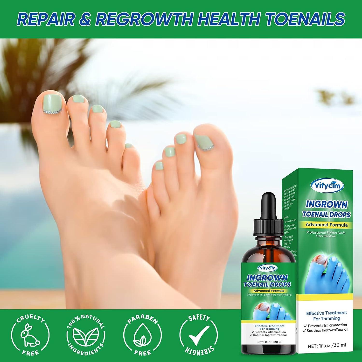 Ingrown Toenail Treatment Drops - Fast Acting Pain Relief & Softener ...