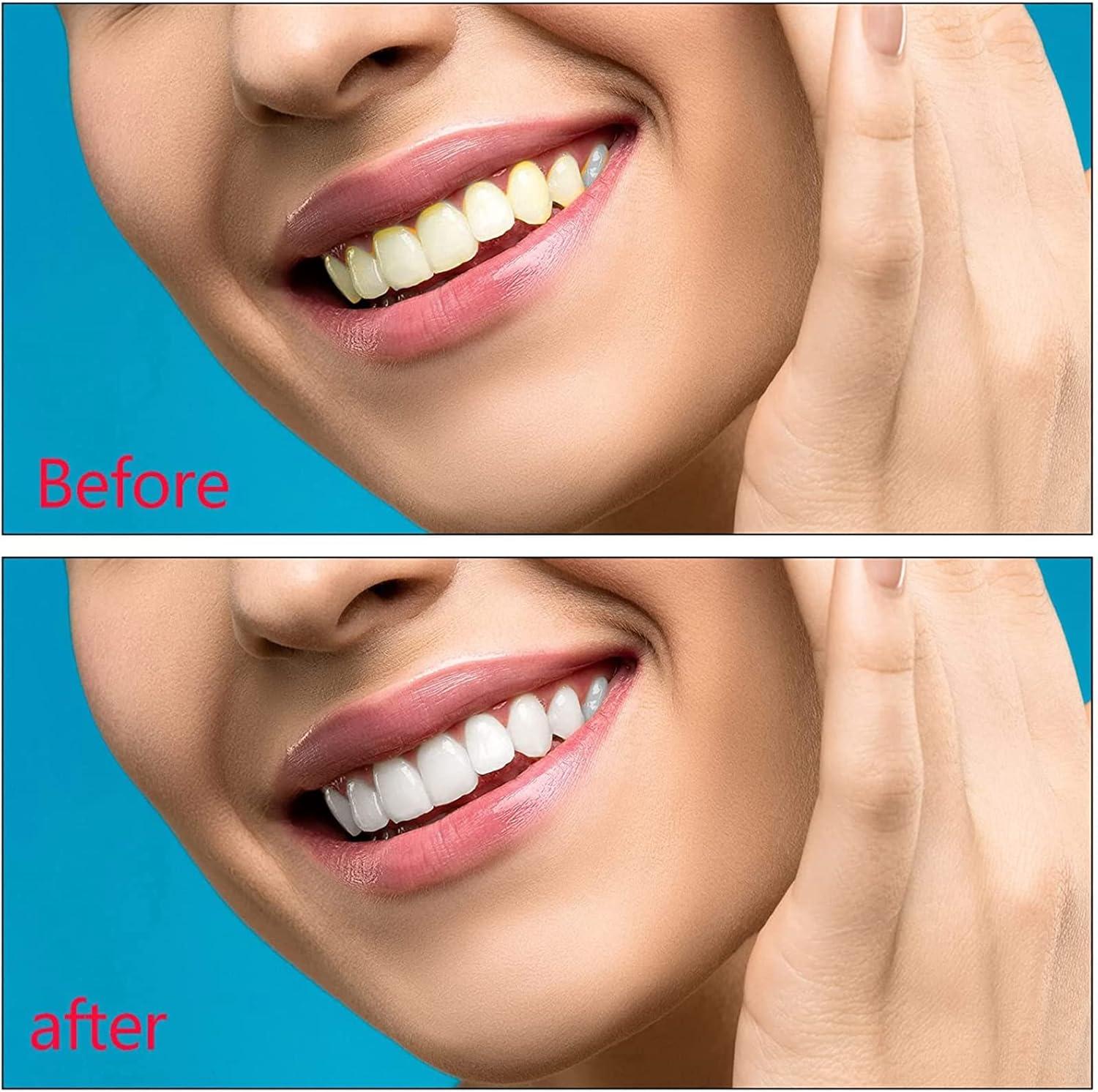 Mxrfactory Instant Veneers & Snap-On Dentures - Comfortable Upper ...