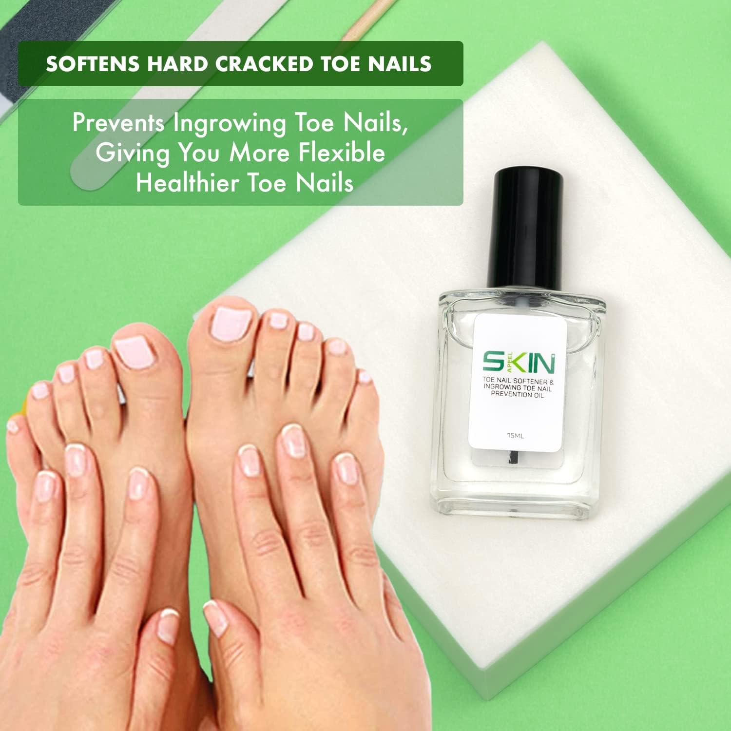 Skinapeel Toe Nail Softener and Ingrown Toenail Treatment Oil - For ...