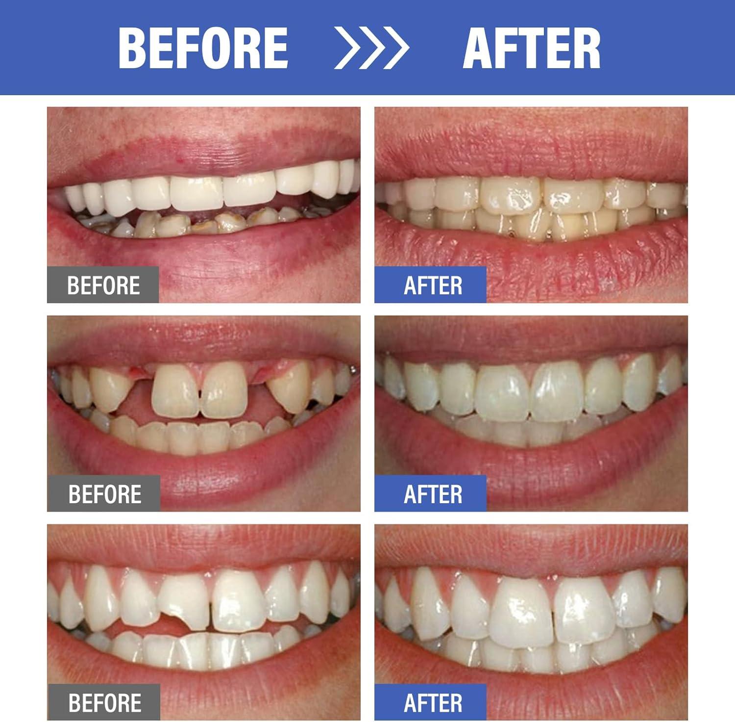 Tooth Filling Repair Kit: Temporary Tooth Kits with Moldable False ...