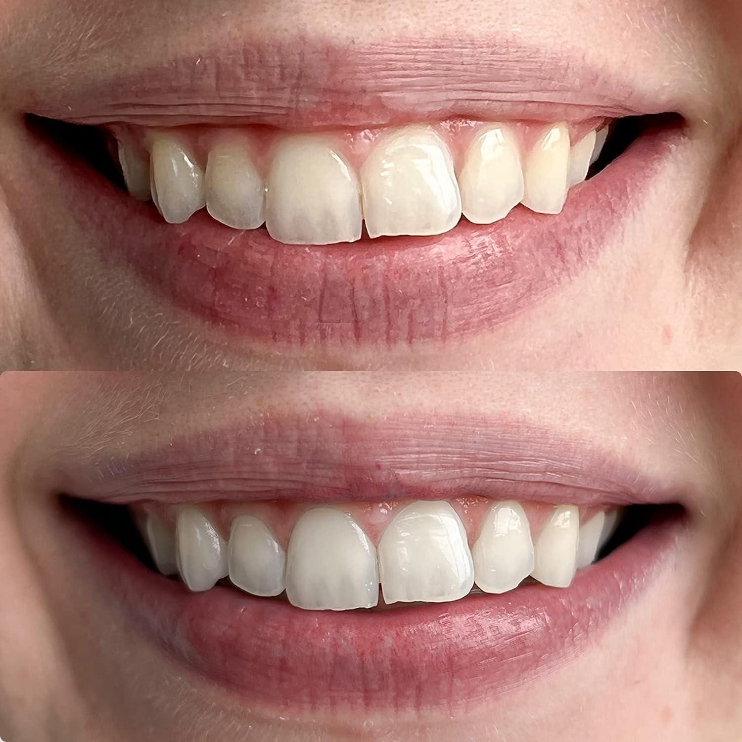 Smile Hero LED Teeth Whitening Kit - Professional At-Home Teeth ...