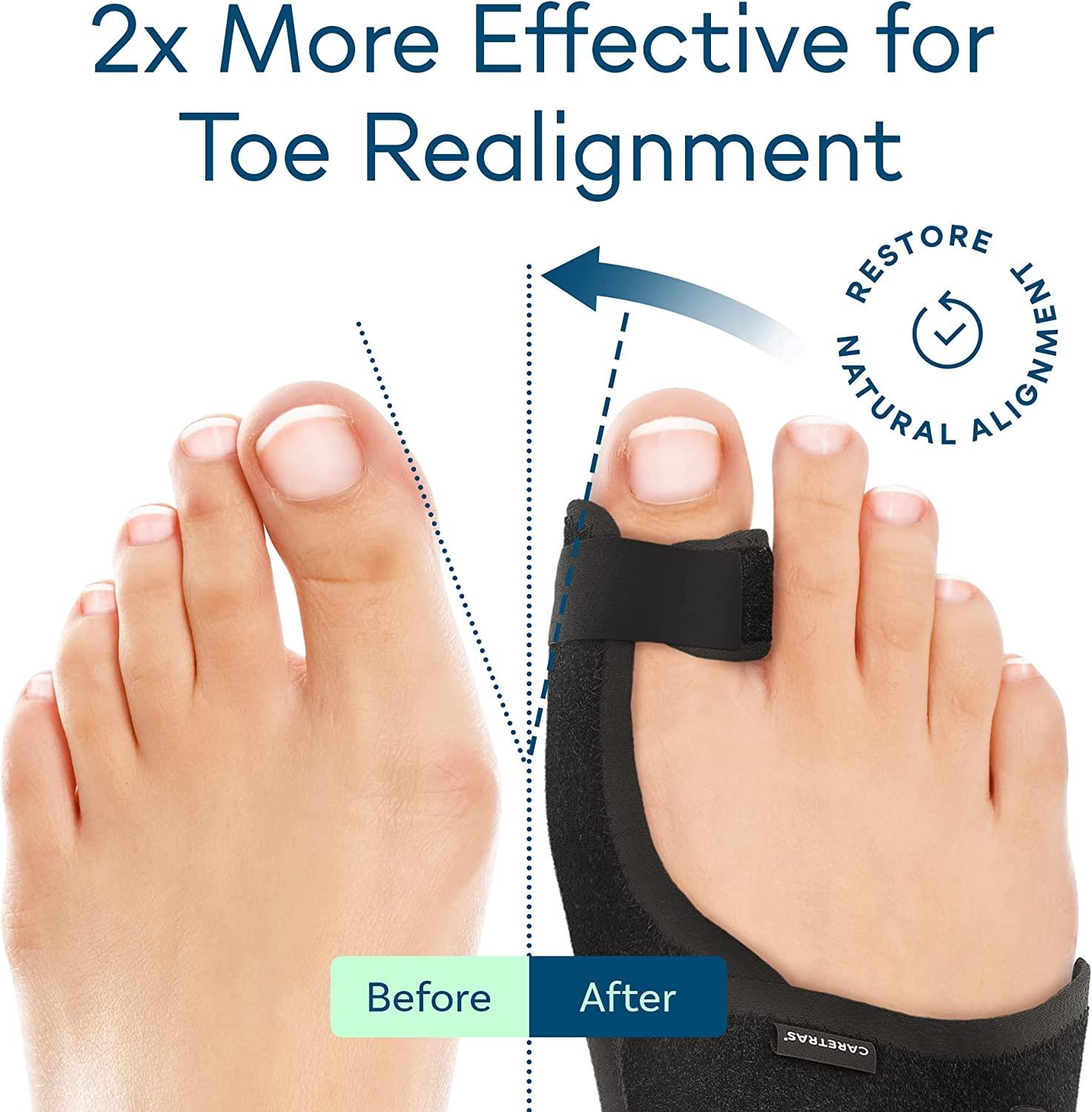 CARETRAS Bunion Corrector Set for Women & Men - Orthopedic Splint for ...