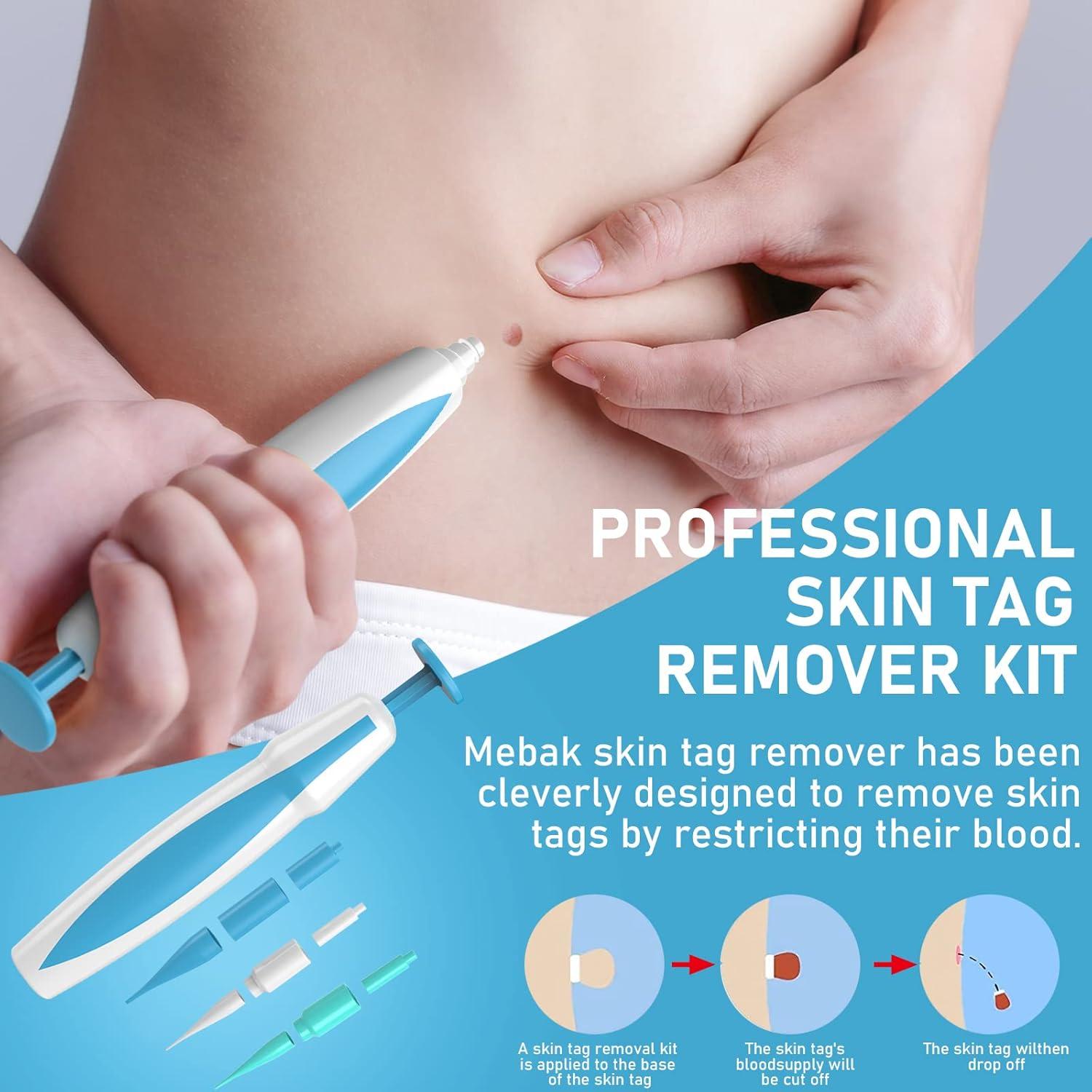 Remove Stem Warts Fast Kit | 2-in-1 Skin Day Remover for Micro to Large ...