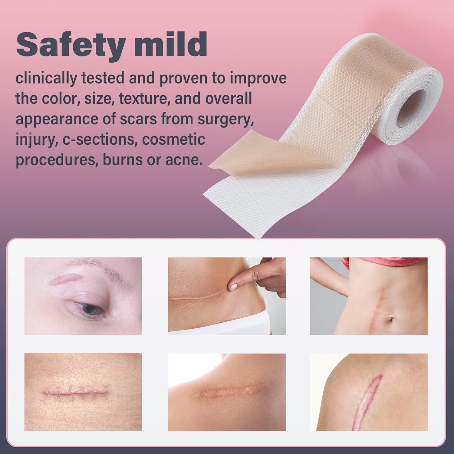Silicon Scar Sheets (4cm*3m) Nude Color Silicone tape Scar Tape Silicon Scar Tape