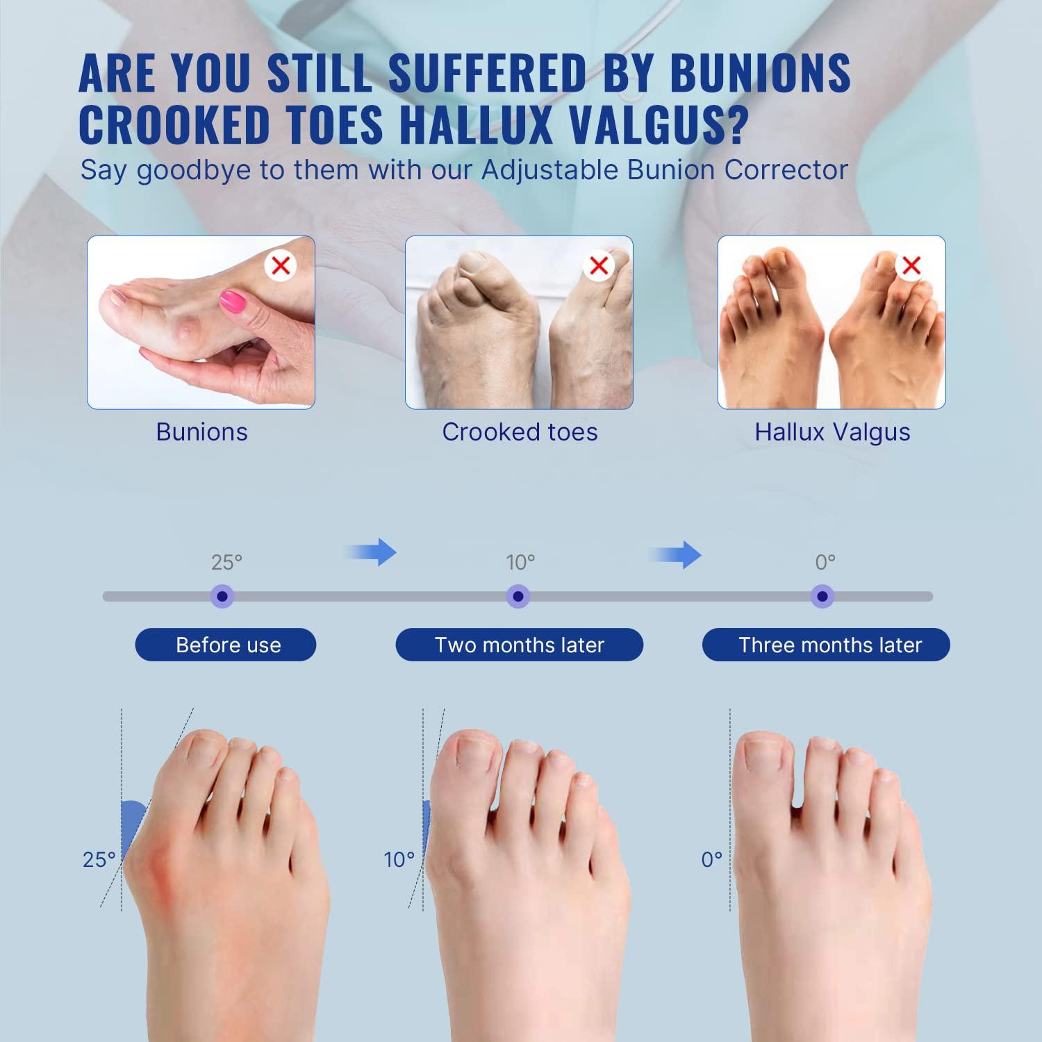 Bunion Corrector Brace for Men and Women - Adjustable Toe Straightener ...