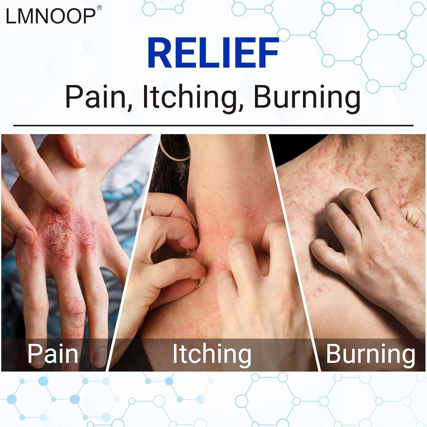 LMNOOP Eczema Cream: Maximum Strength Treatment for Rash, Psoriasis ...