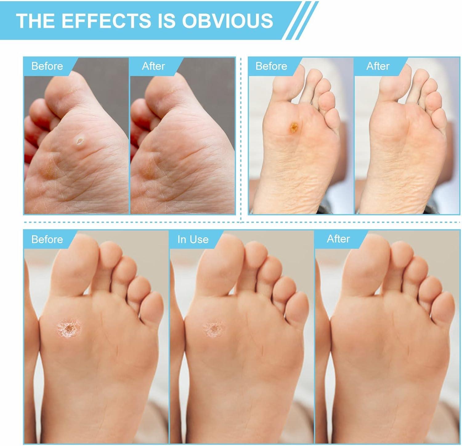 Wart Remover Plasters for Hands & Feet - Corn & Verruca Removal ...