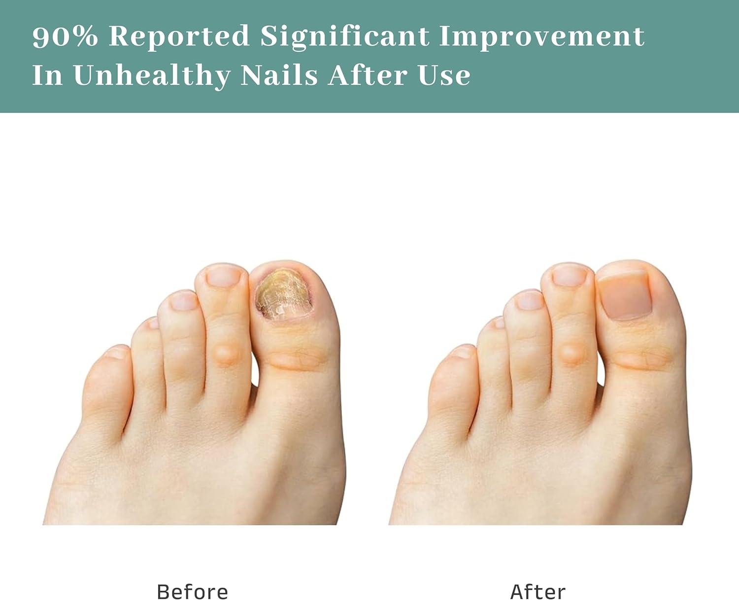 Natural Fungal Nail Treatment Anti Fungal Treatment For Tonails 5ml