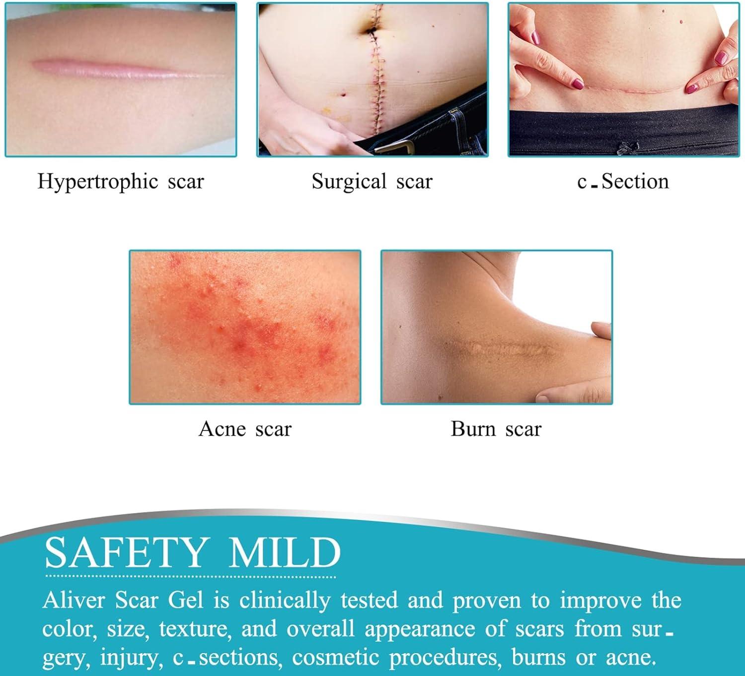 Silicone Surgical Scar Removal Patch for Trauma, Burn, Acne Treatment ...