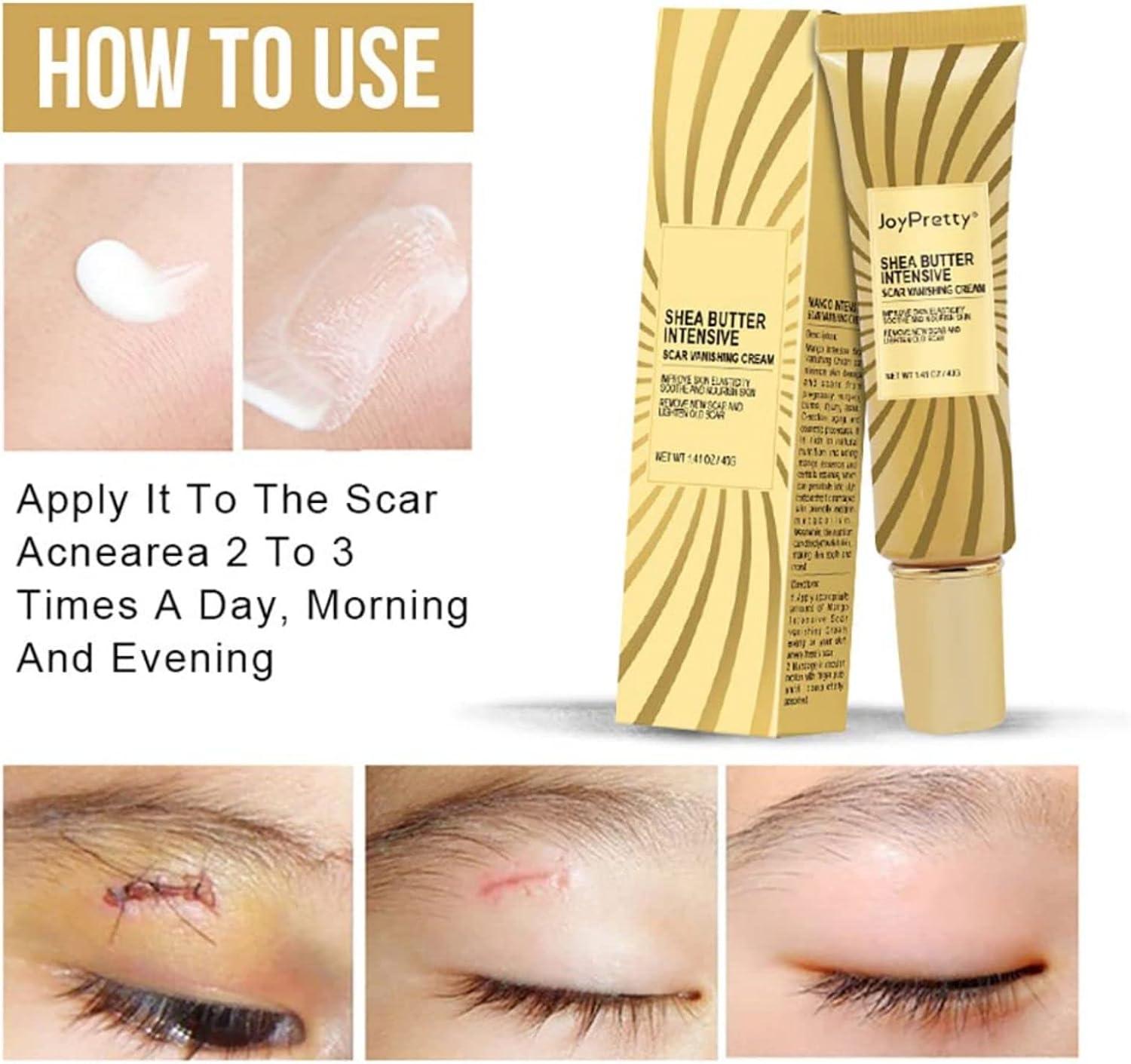 Yuemei Scar Vanishing Cream - Strengthen Skin Repair, Remove Old Scars ...