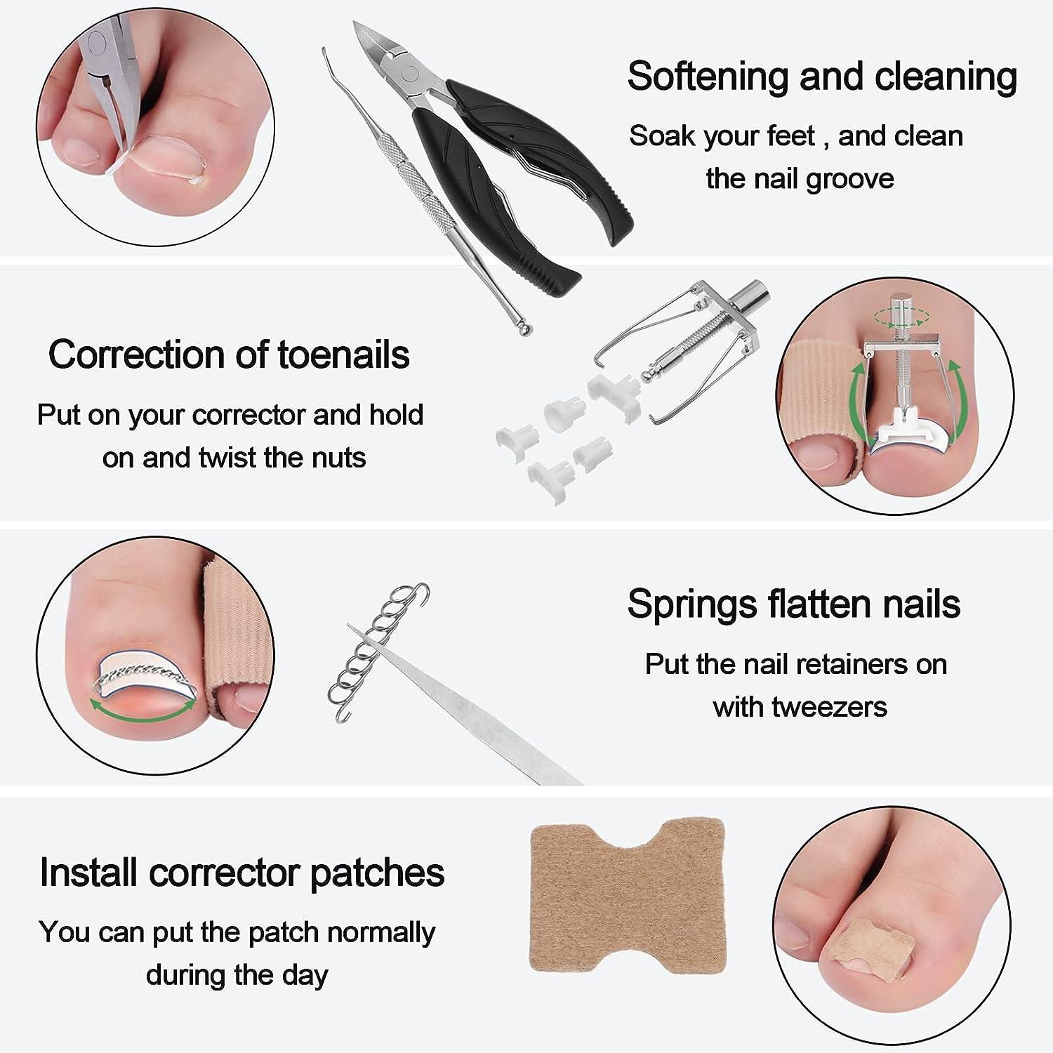 Ingrown Toenail Treatment Kit | Toe Nail Correction Tool Set with ...