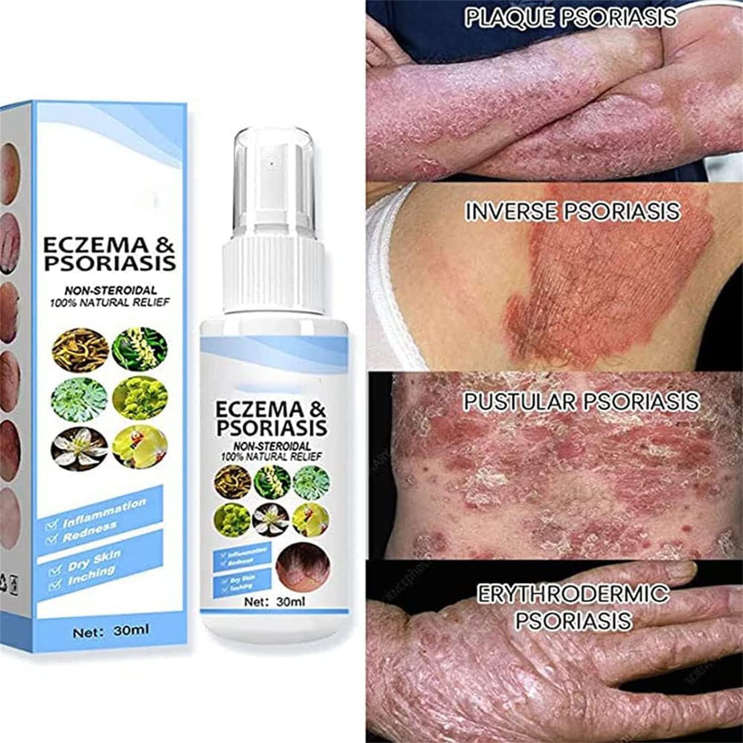 Herbal Psoriasis, Eczema, and Vitiligo Relief Spray Trio - Skin Repair ...