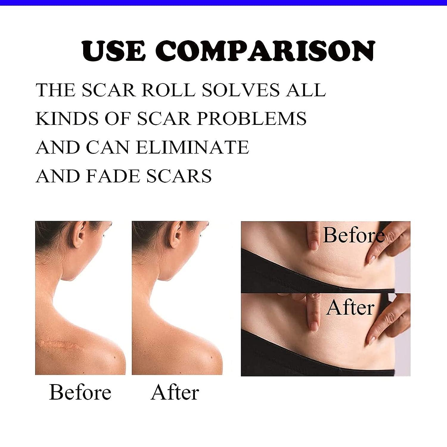 Silicone Scar Tape Roll - Easy-Tear Gel Tape for Surgery Scars - 1.6 x ...