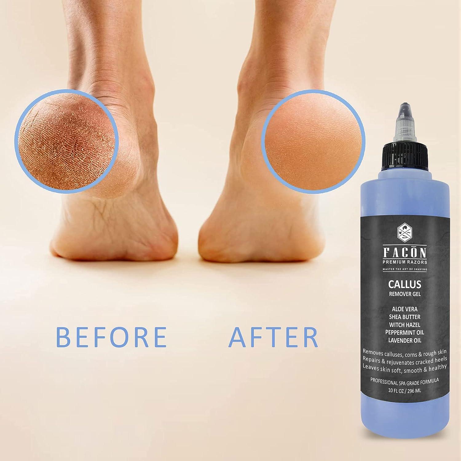 Facn Professional Clear Callus Remover Gel with Aloe Vera, Shea Butter ...
