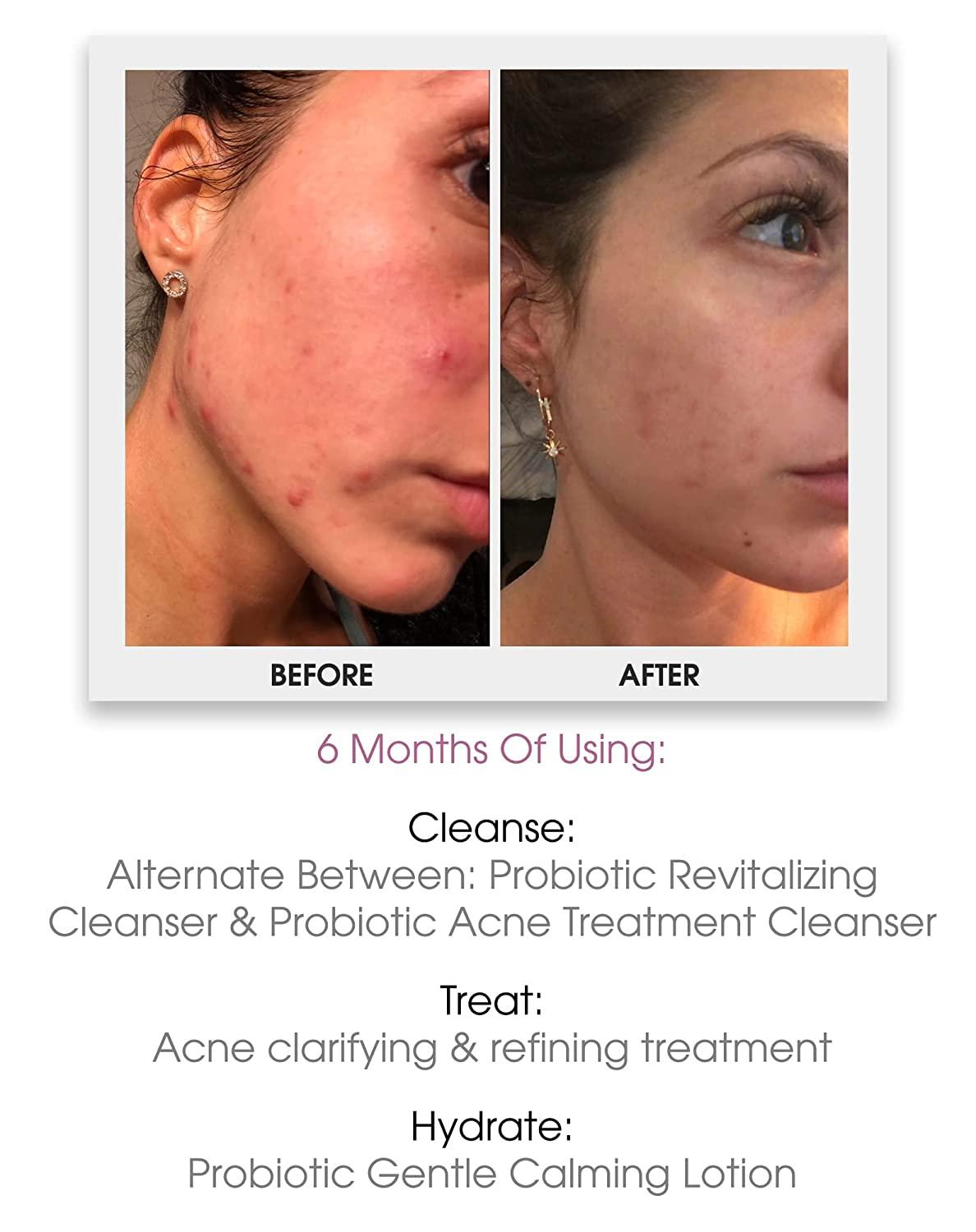 GLOWBIOTCS MD Probiotic Acne Treatment Cleanser - Gentle & Non-Drying ...