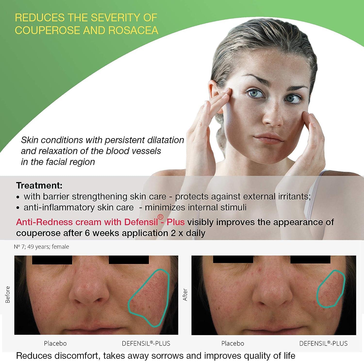 Redness Relief Face Eczema Cream - All-Natural Anti-Itch Treatment for ...