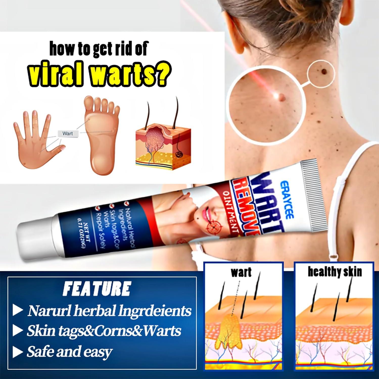 Wart Removal Cream 20g Effective Treatment of Warts Corns Spot Moles ...