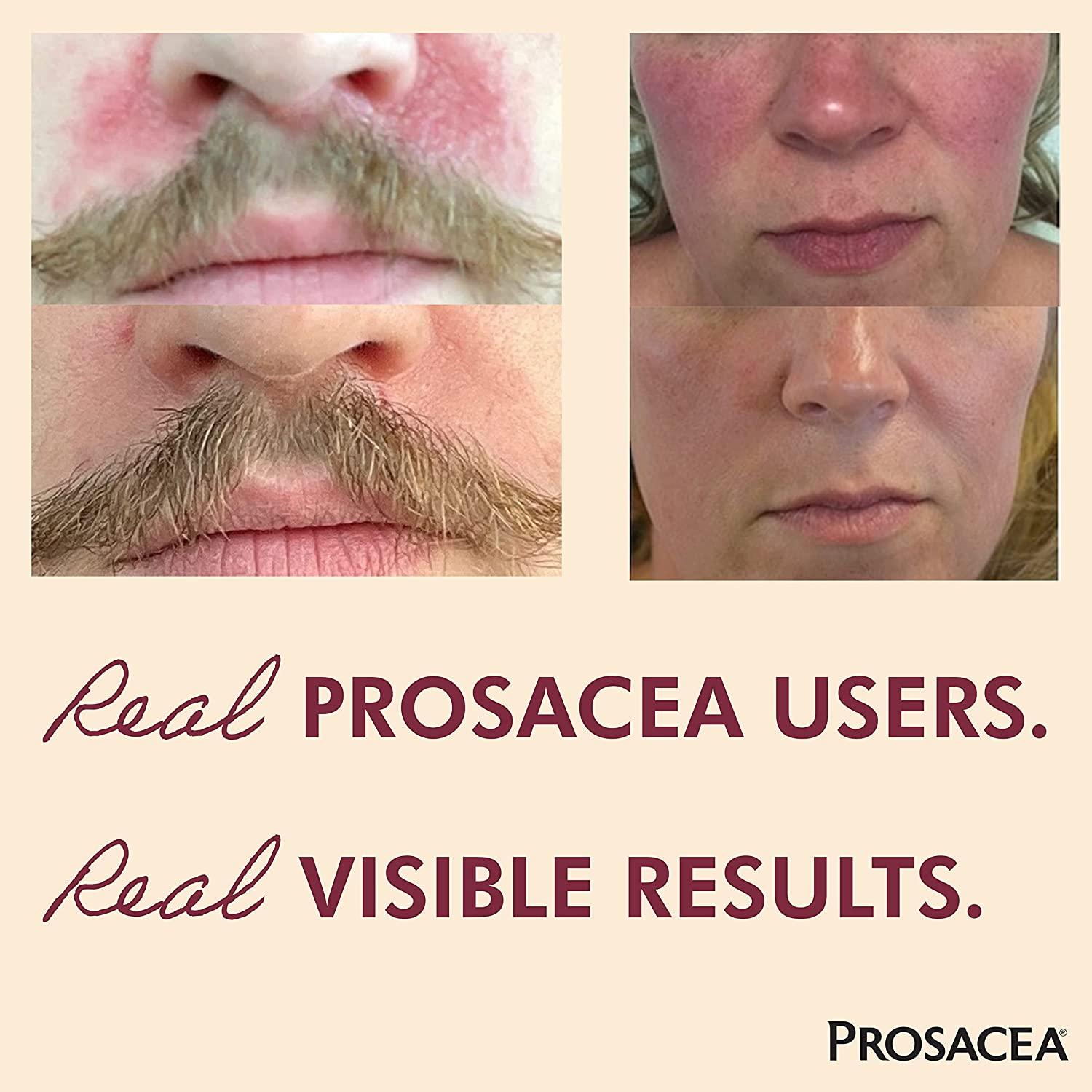 Prosacea Rosacea Treatment - 0.75 oz - Reduces Redness, Pimples, and ...