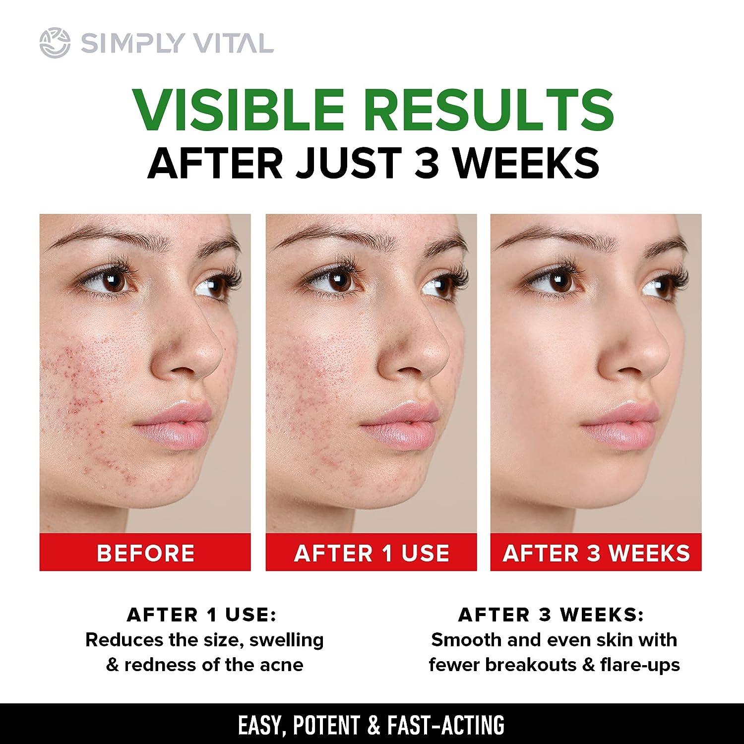 Acne Medication Face Cream - Fast Acting USA-Made Treatment for ...