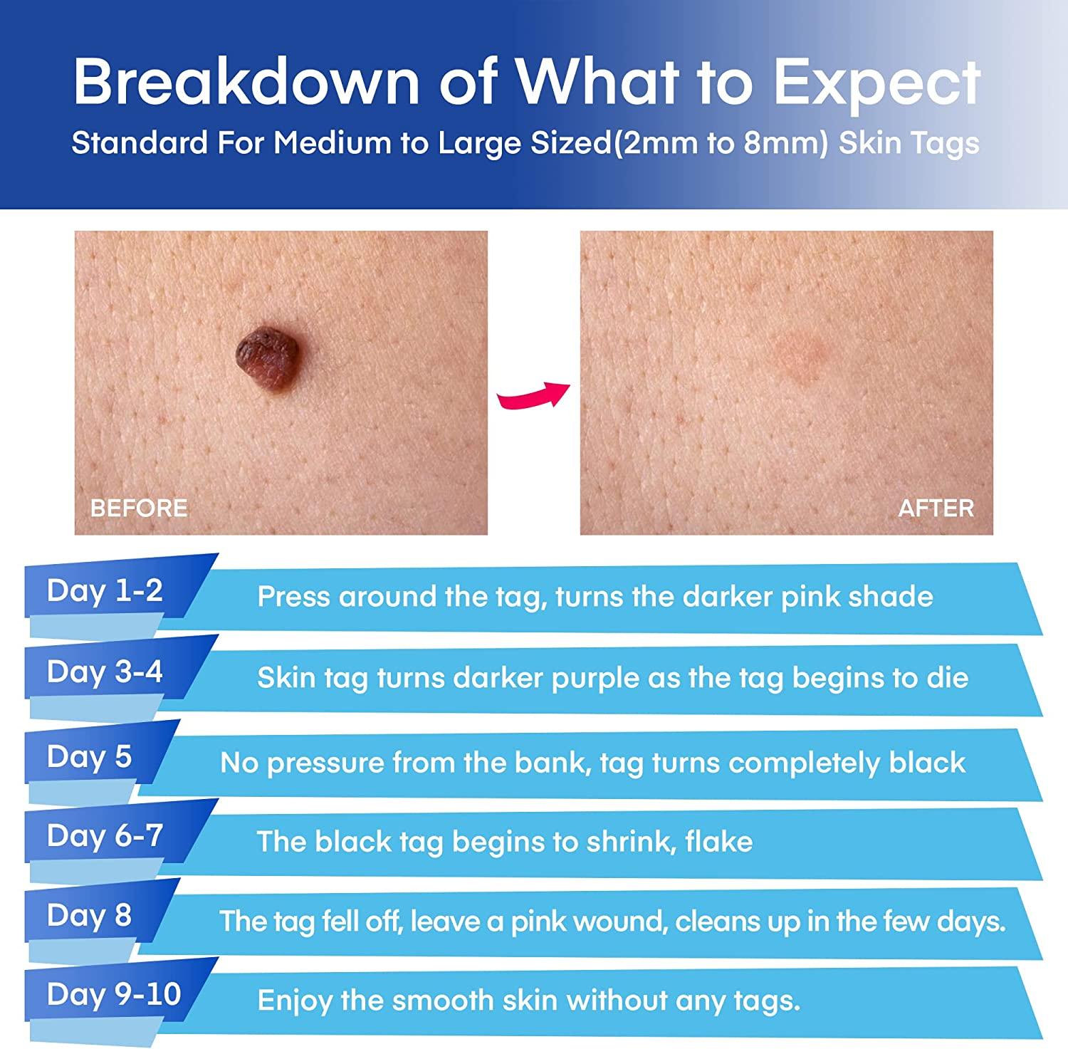 Natural Skin Tag Remover Device Kit for 2-8mm Tags | Easy, Safe ...