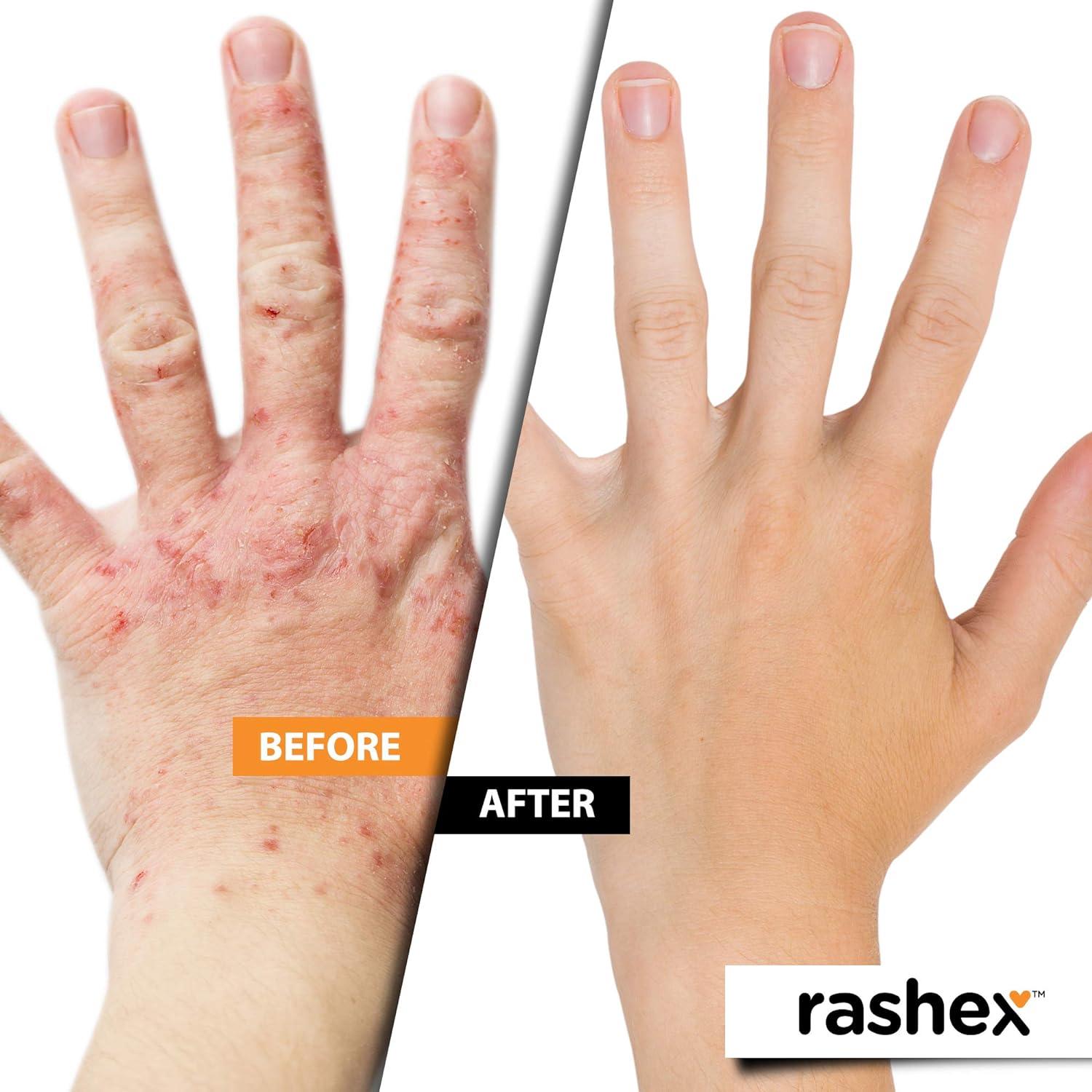 Rashex Eczema & Psoriasis Treatment Ointment | Black Ichthammol 20% ...