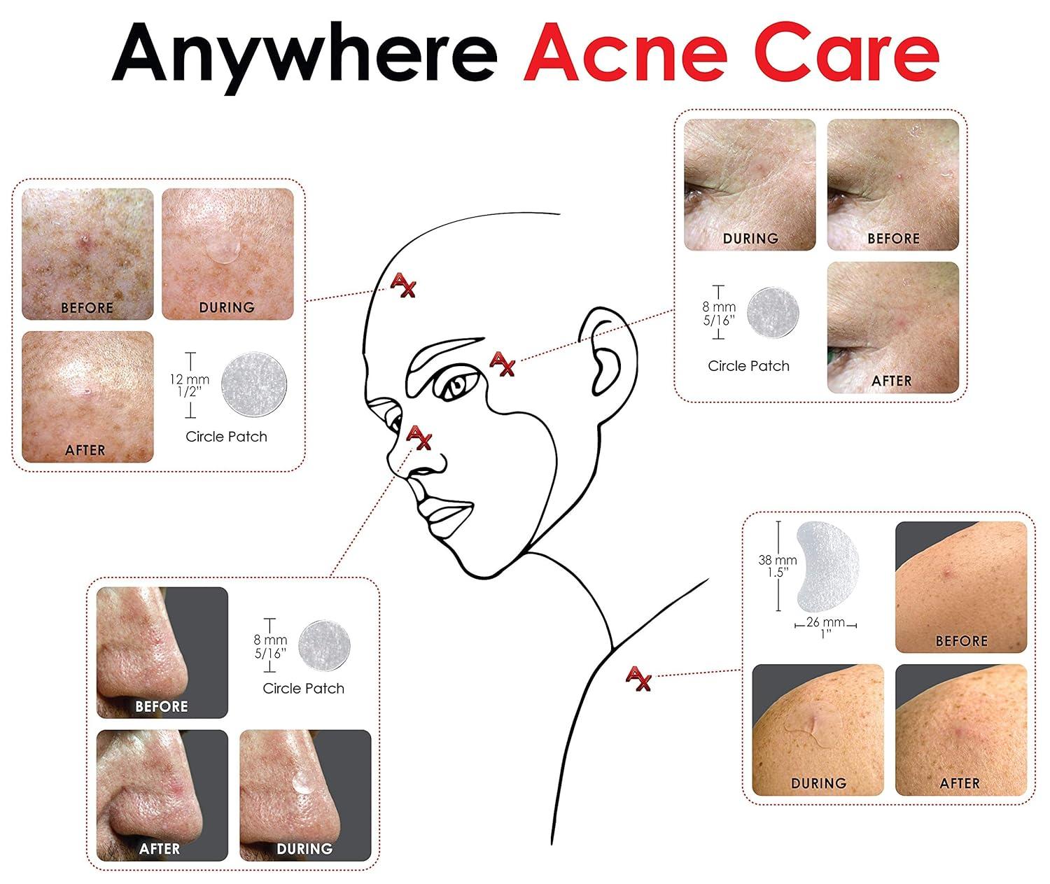 AX Acne Hydrocolloid Pimple Patch Bandage Variety Pack | Skincare Spot ...