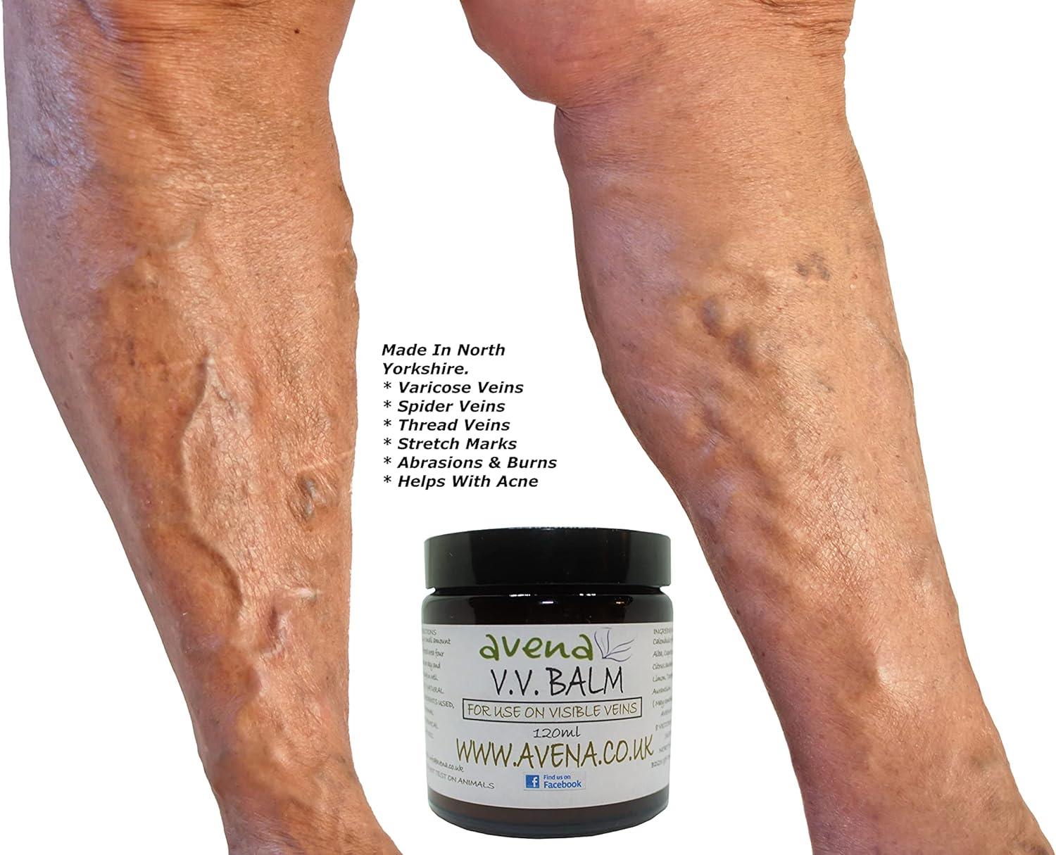 Varicose Veins Balm 120ml - Treatment for Varicose, Spider Veins, Acne ...