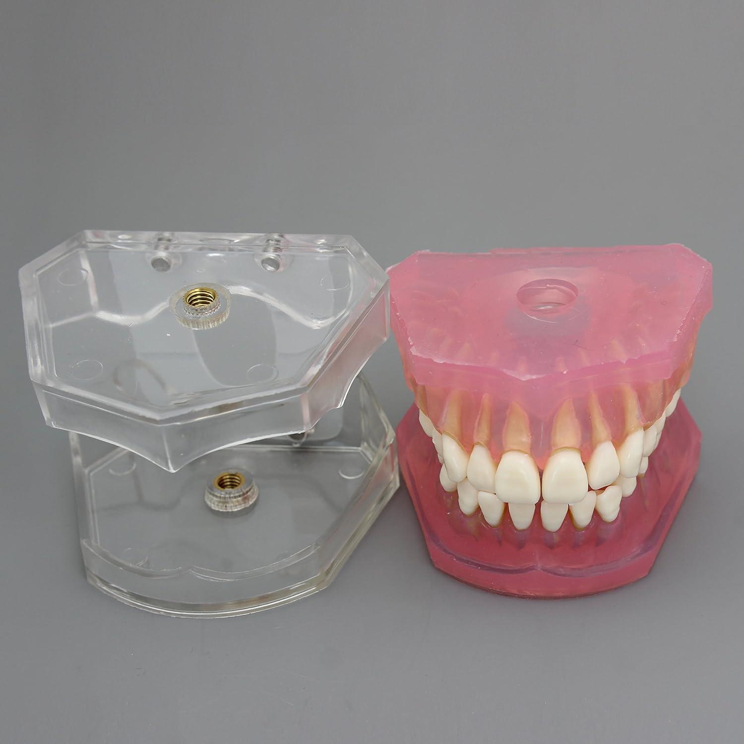 Dental Implant Teeth Model - Standard Study and Teaching Tool with ...