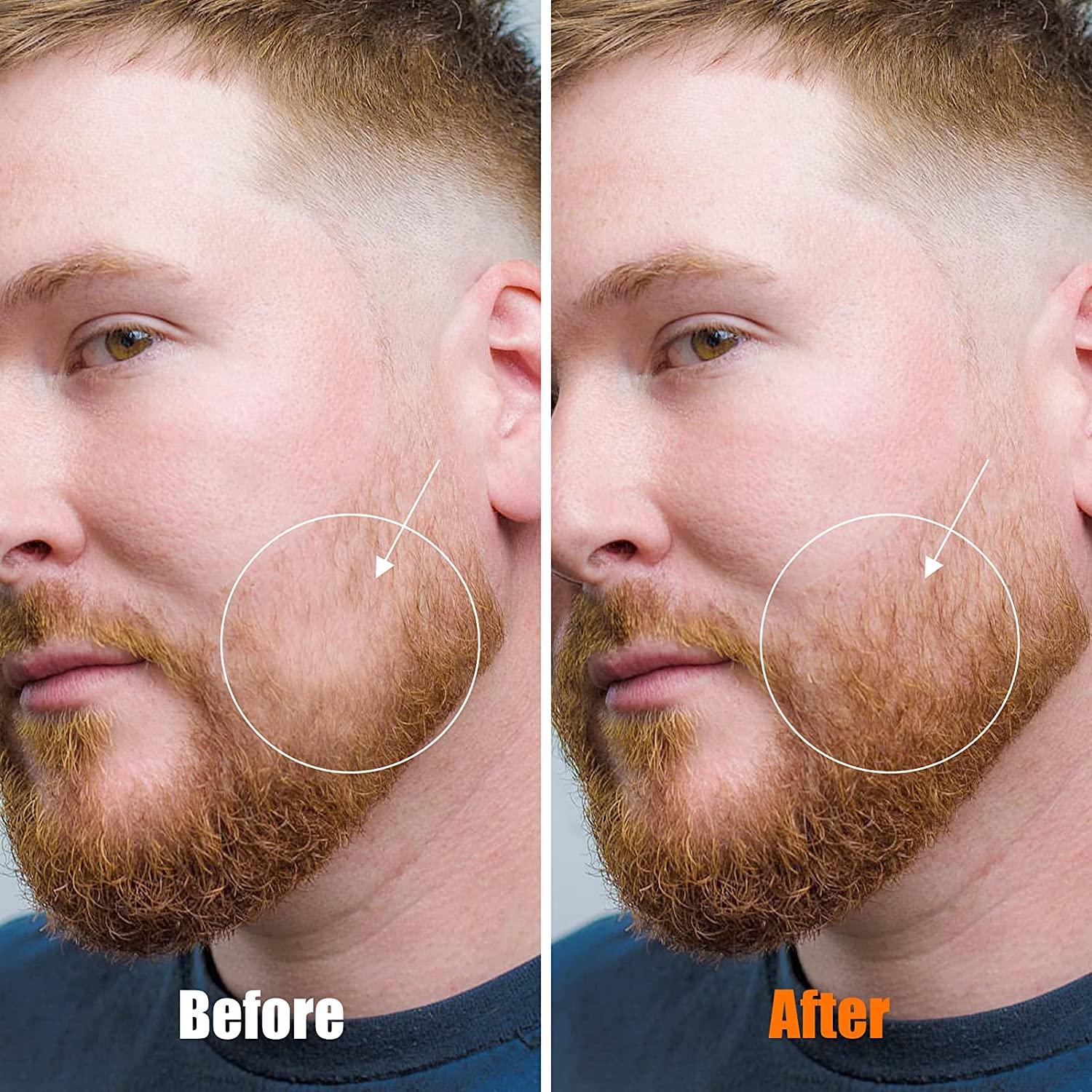 5% Minoxidil Beard Growth Kit with Derma Roller and Growth Oil for Men - 0.25mm Microneedle ...