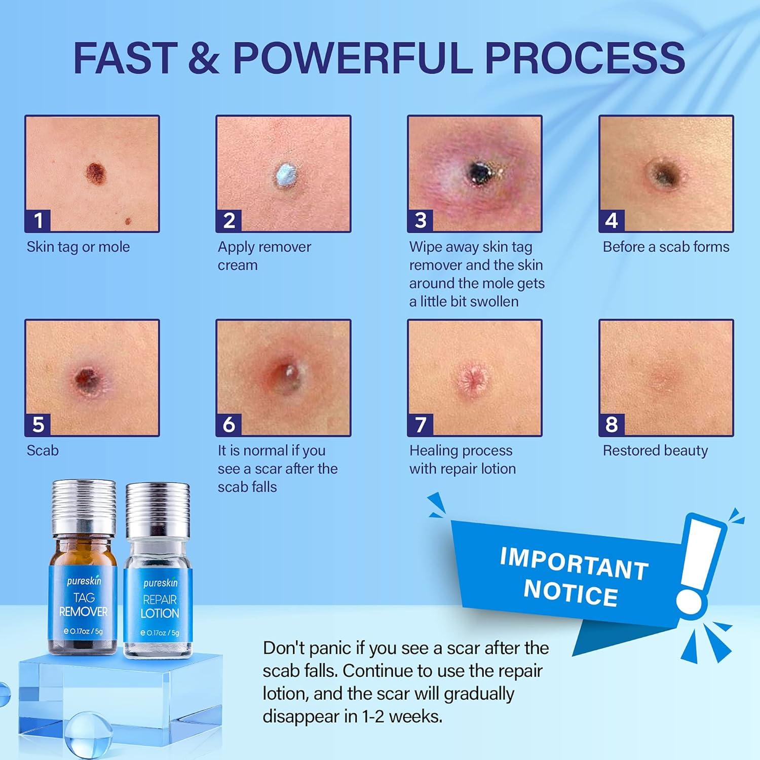 skin tag removal scab