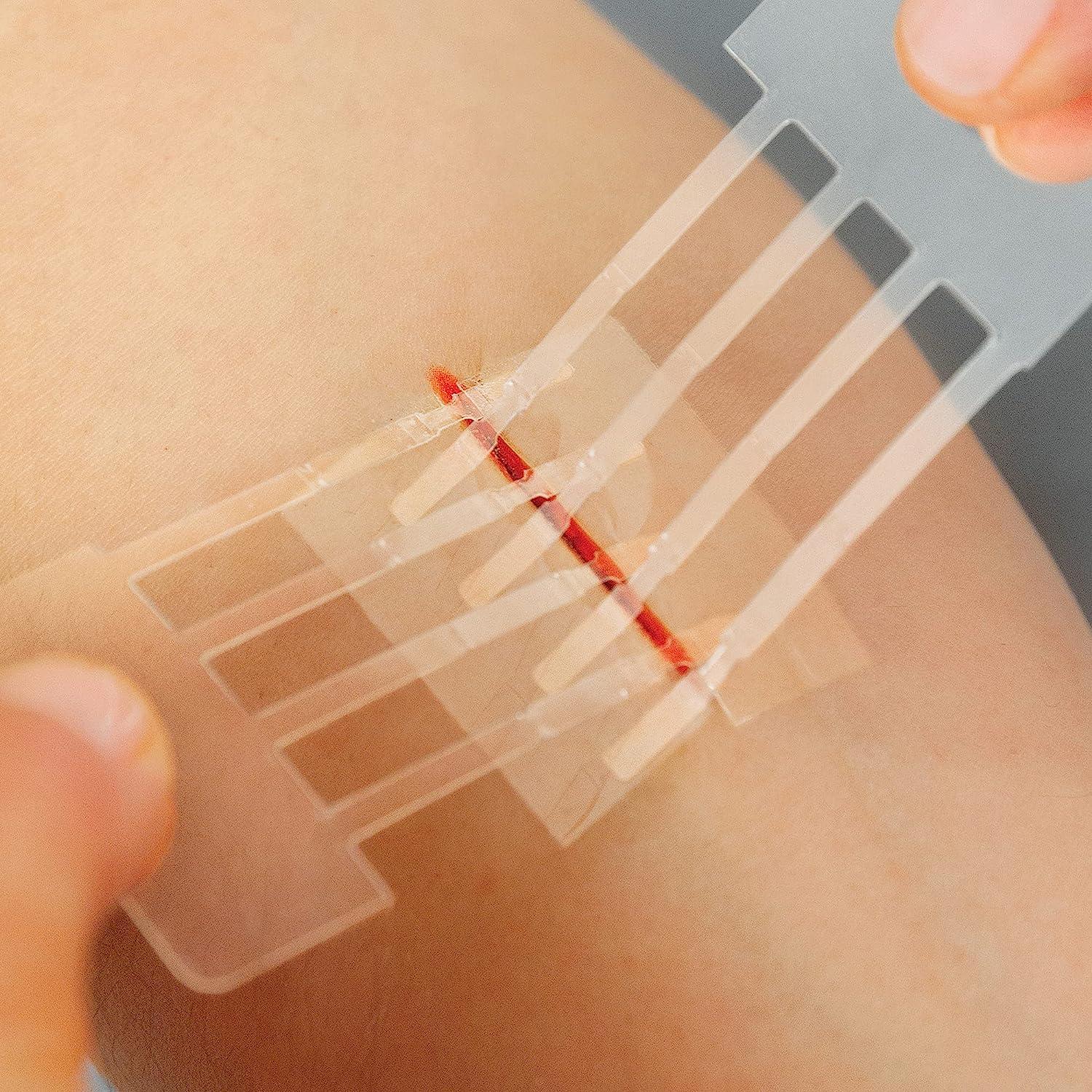 FDA Cleared Clozex Emergency Laceration Closures - Repair Wounds ...
