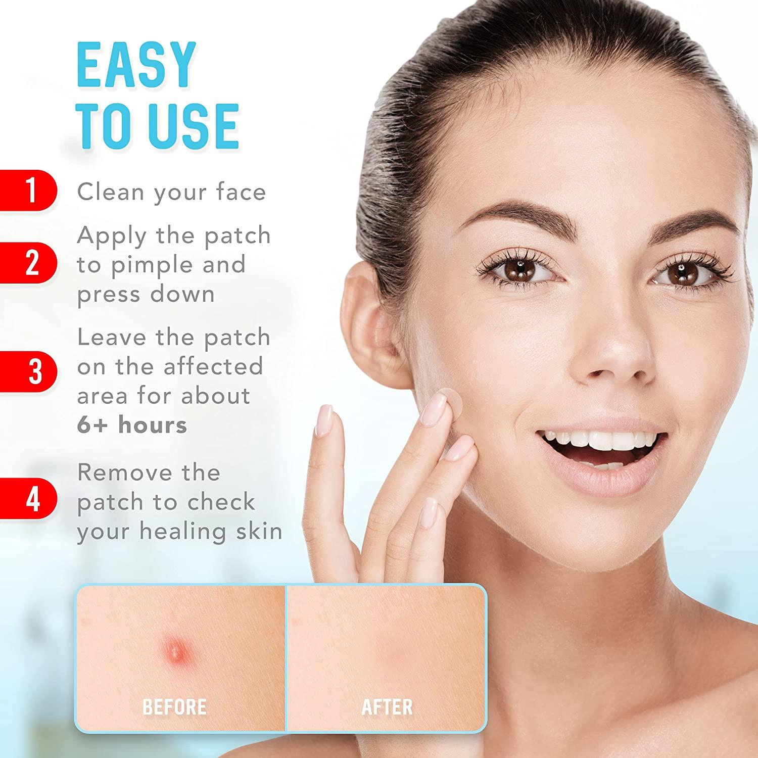 Hydrocolloid Acne Patches 120 Pack With Tea Tree Oil Pimple