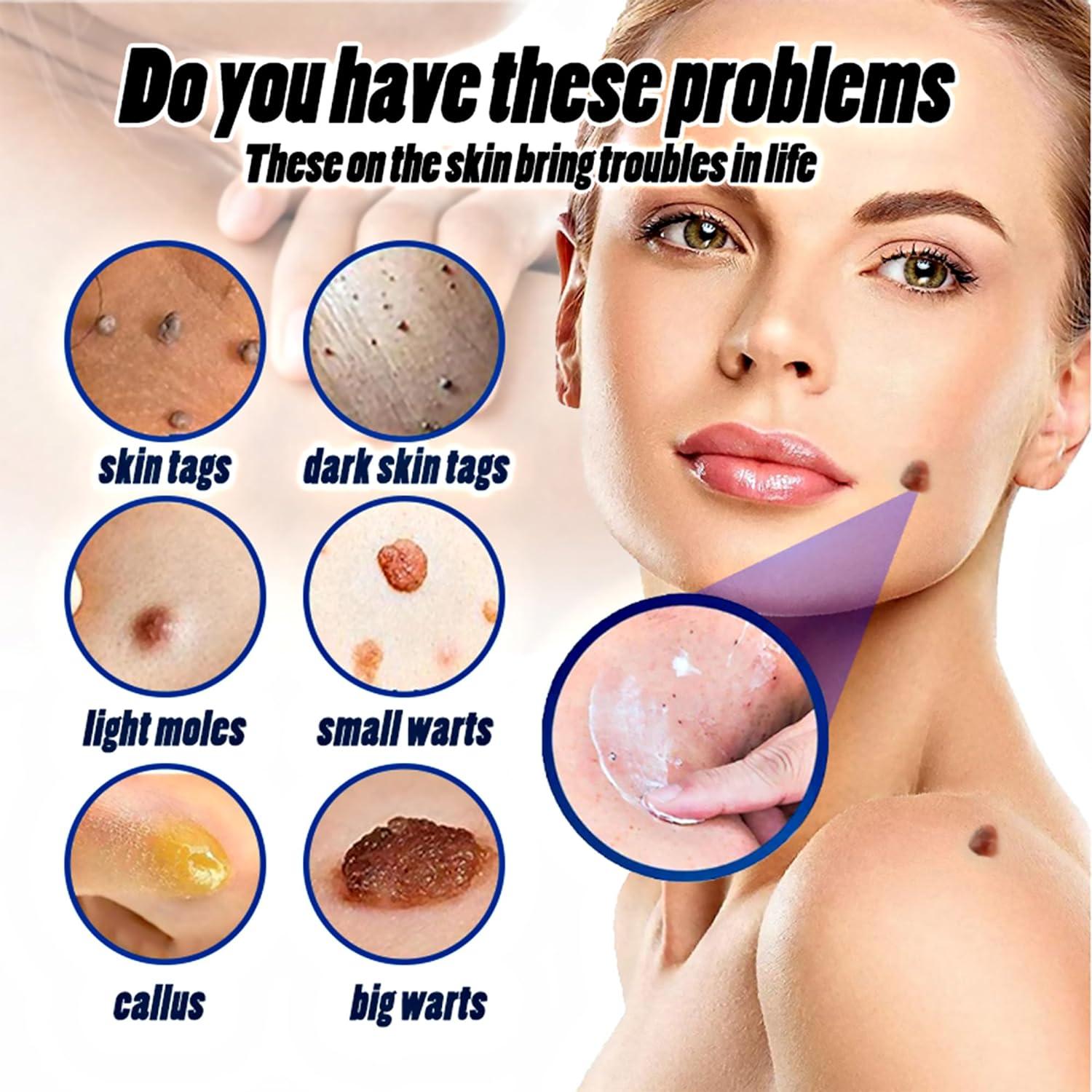 Wart Removal Cream 20g Effective Treatment of Warts Corns Spot Moles ...