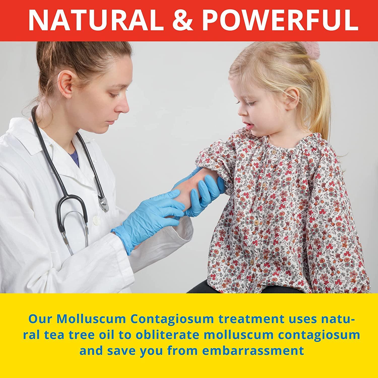 Molluscum Contagiosum Treatment: Fast, Safe, Painless Solution for Children and Adults - 1 Month ...