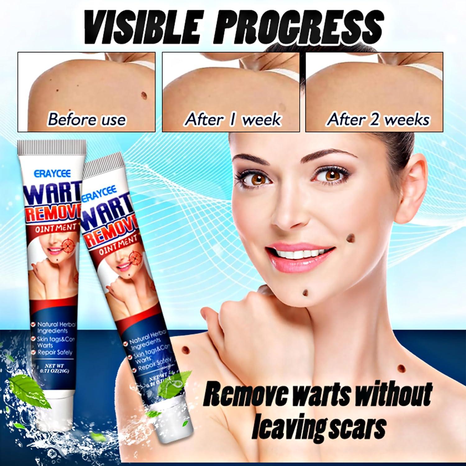 Wart Removal Cream 20g Effective Treatment of Warts Corns Spot Moles ...