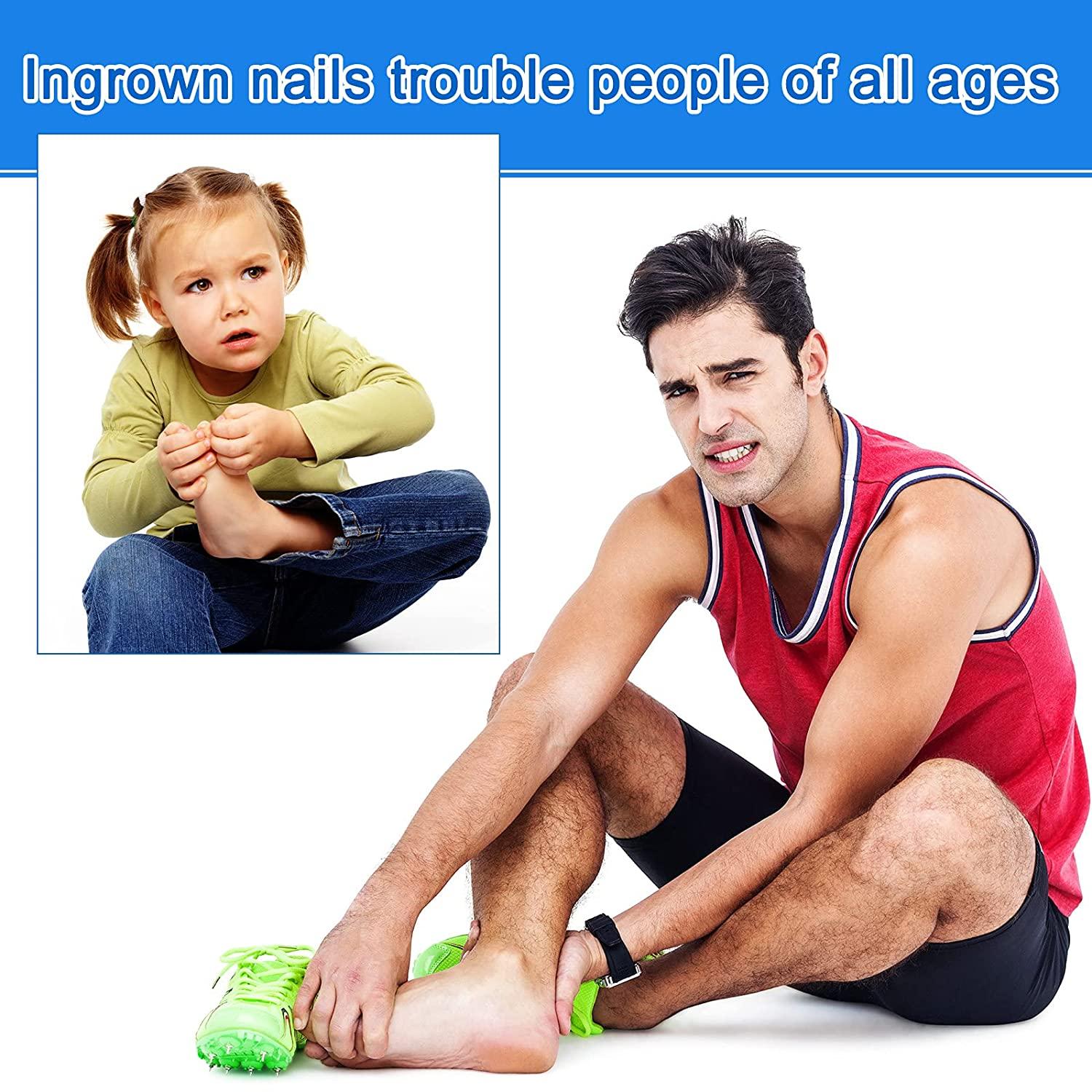 Ingrown Toenail Correction Kit - 103 Pack with 100 Corrector Strips ...