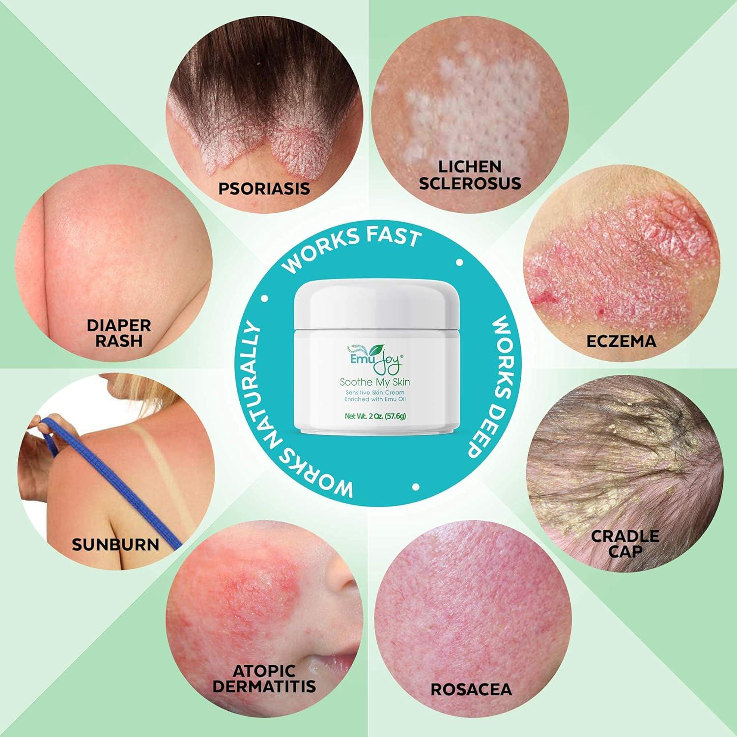 Soothe My Skin Cream for Sensitive Skin - Eczema Cream Psoriasis Atopic ...