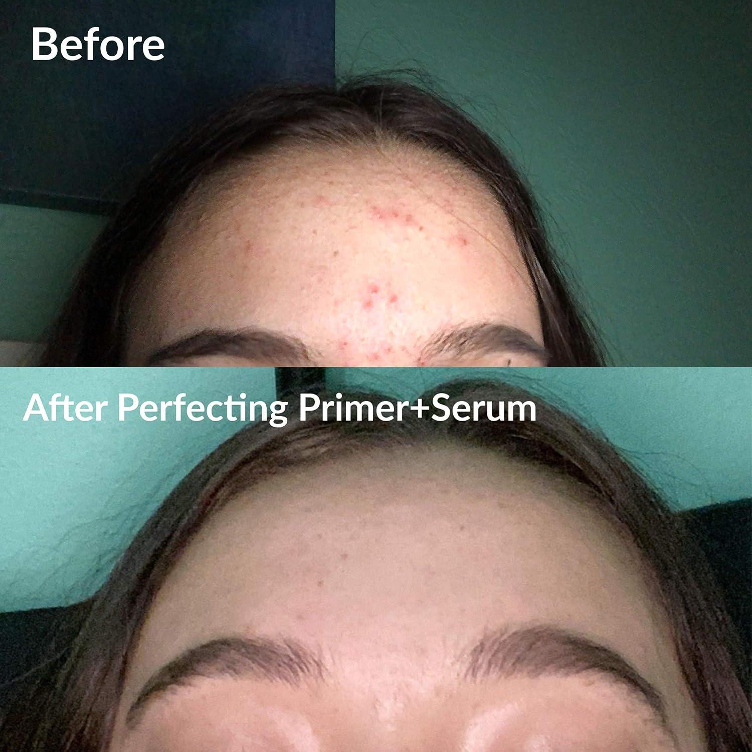 Frilliance 2 in 1 Clear Skin Primer & Serum for Acne - Vegan, Cruelty ...