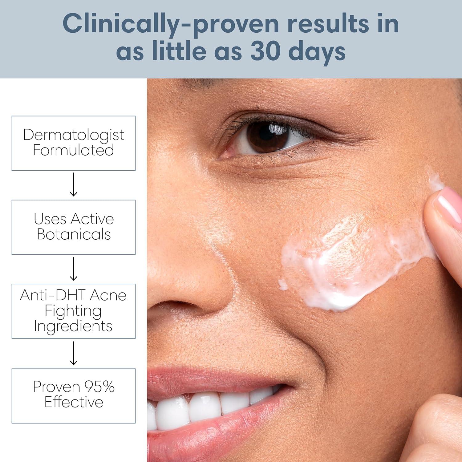 Hormonal Acne Solution | Natural Anti-DHT Benzoyl Peroxide Formula | 1 ...