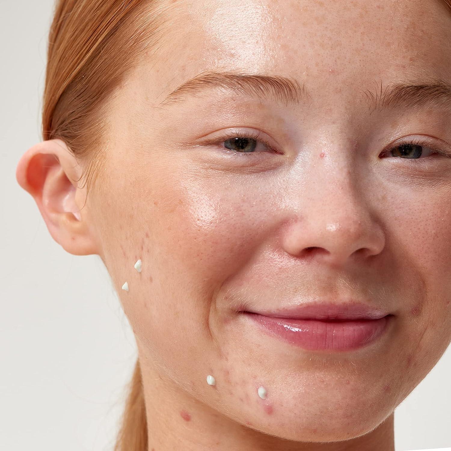 INKEY List Succinic Acid Acne Treatment - Clear Blemishes and Unclog ...
