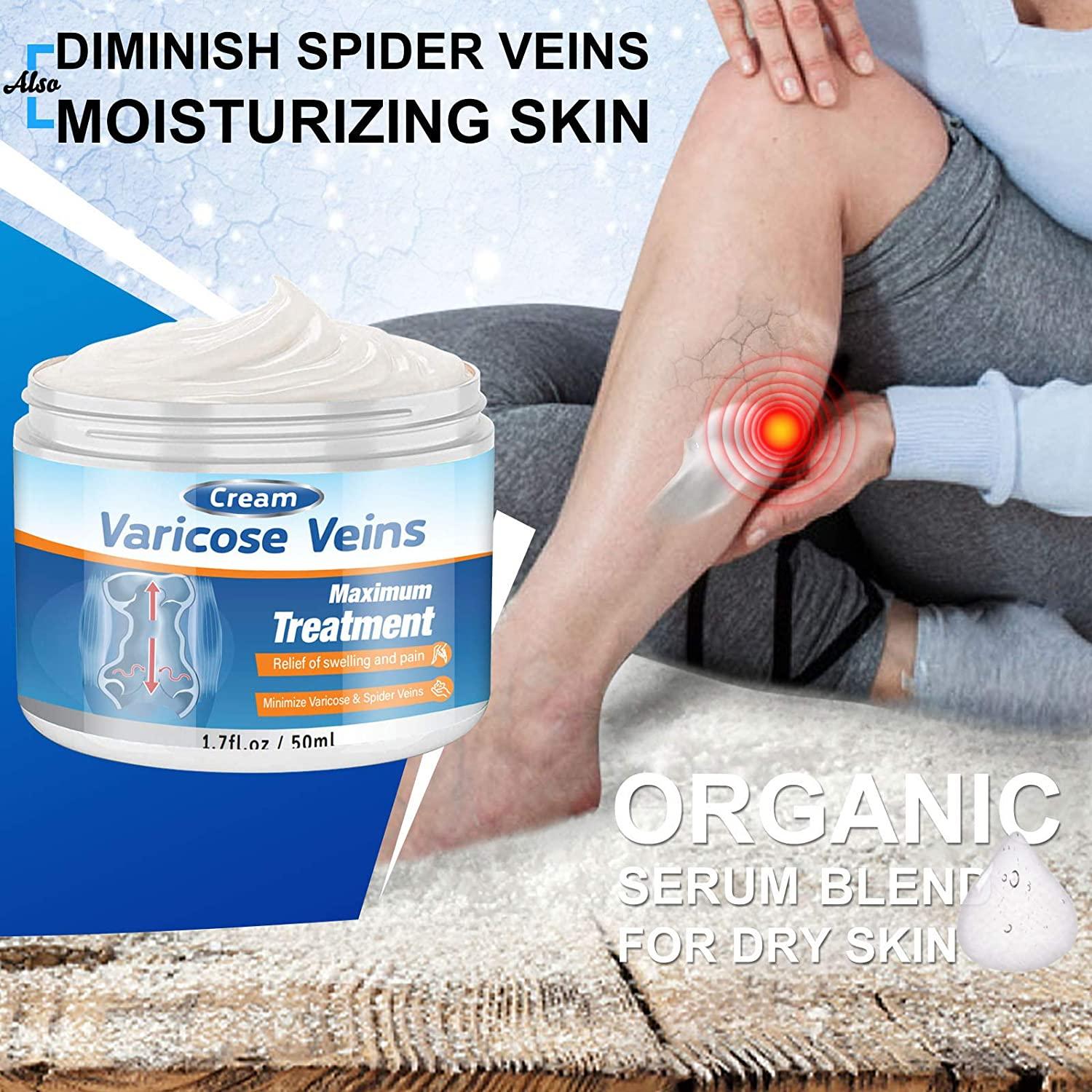Varicose Veins Cream - Effective Treatment for Leg Relief, Phlebitis ...