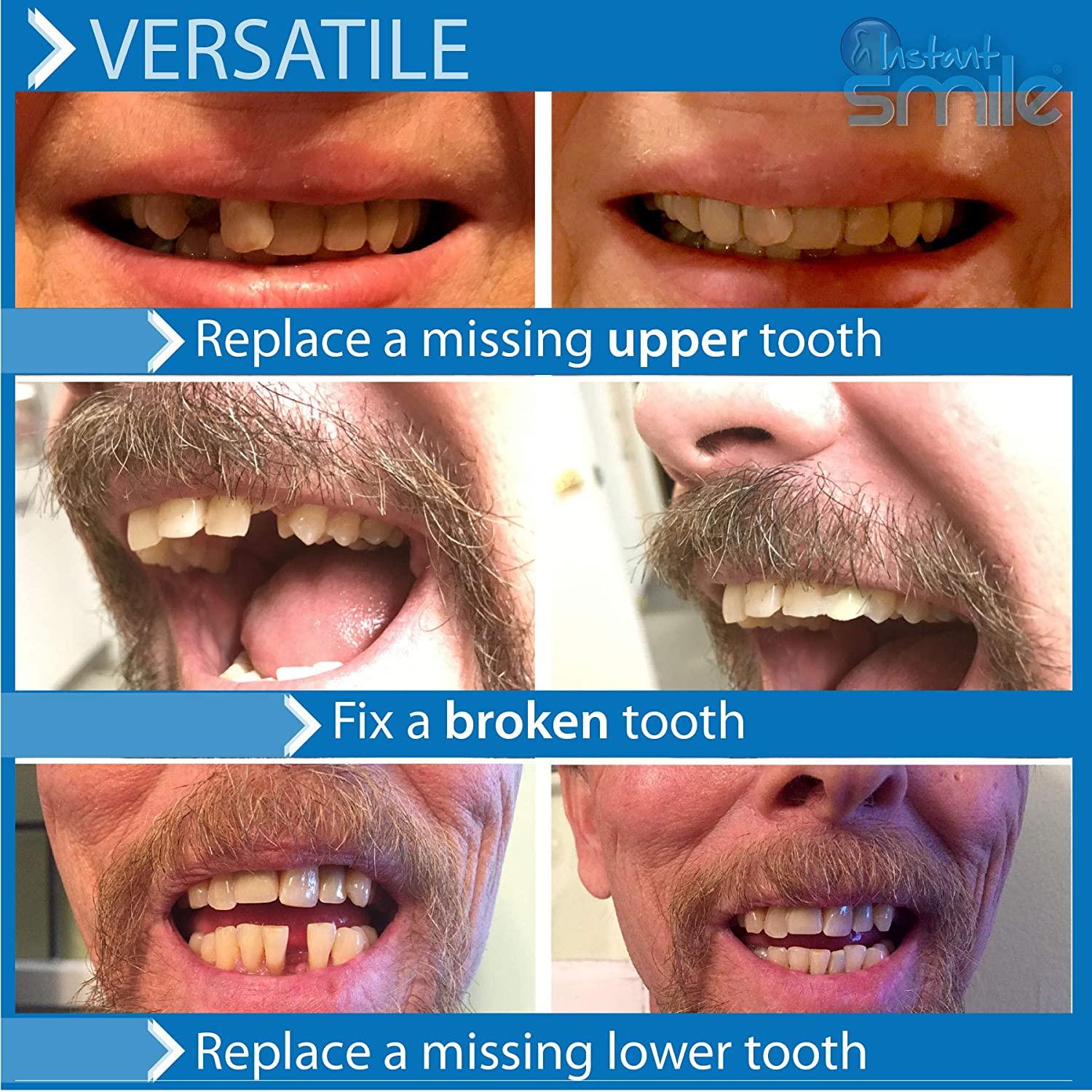 Instant Smile Temporary Tooth Kit - Pro-Series: Transform Your Smile ...