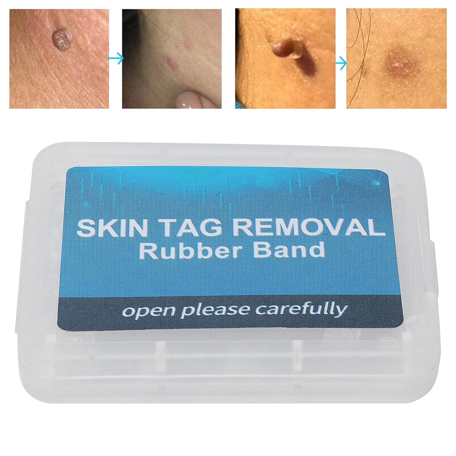 30-Piece Day Distance Rubber Bands for Skin Tag & Wart Removal | Micro ...