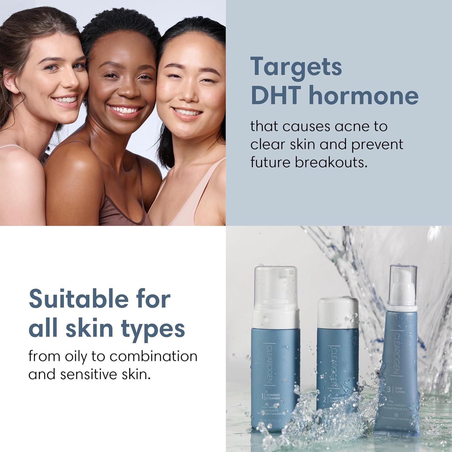 Hormonal Acne Solution | Natural Anti-DHT Benzoyl Peroxide Formula | 1 ...