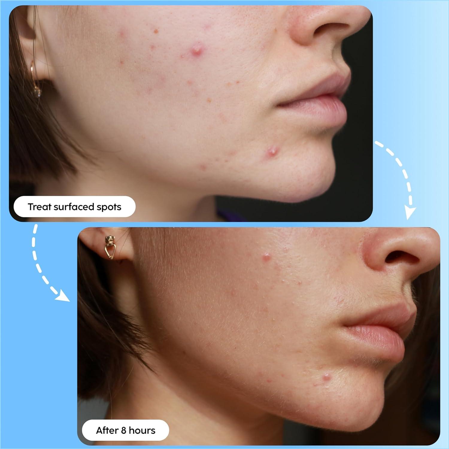 Patch Perfect Spot Patches (102 Pimple Patches) - Hydrocolloid Acne ...